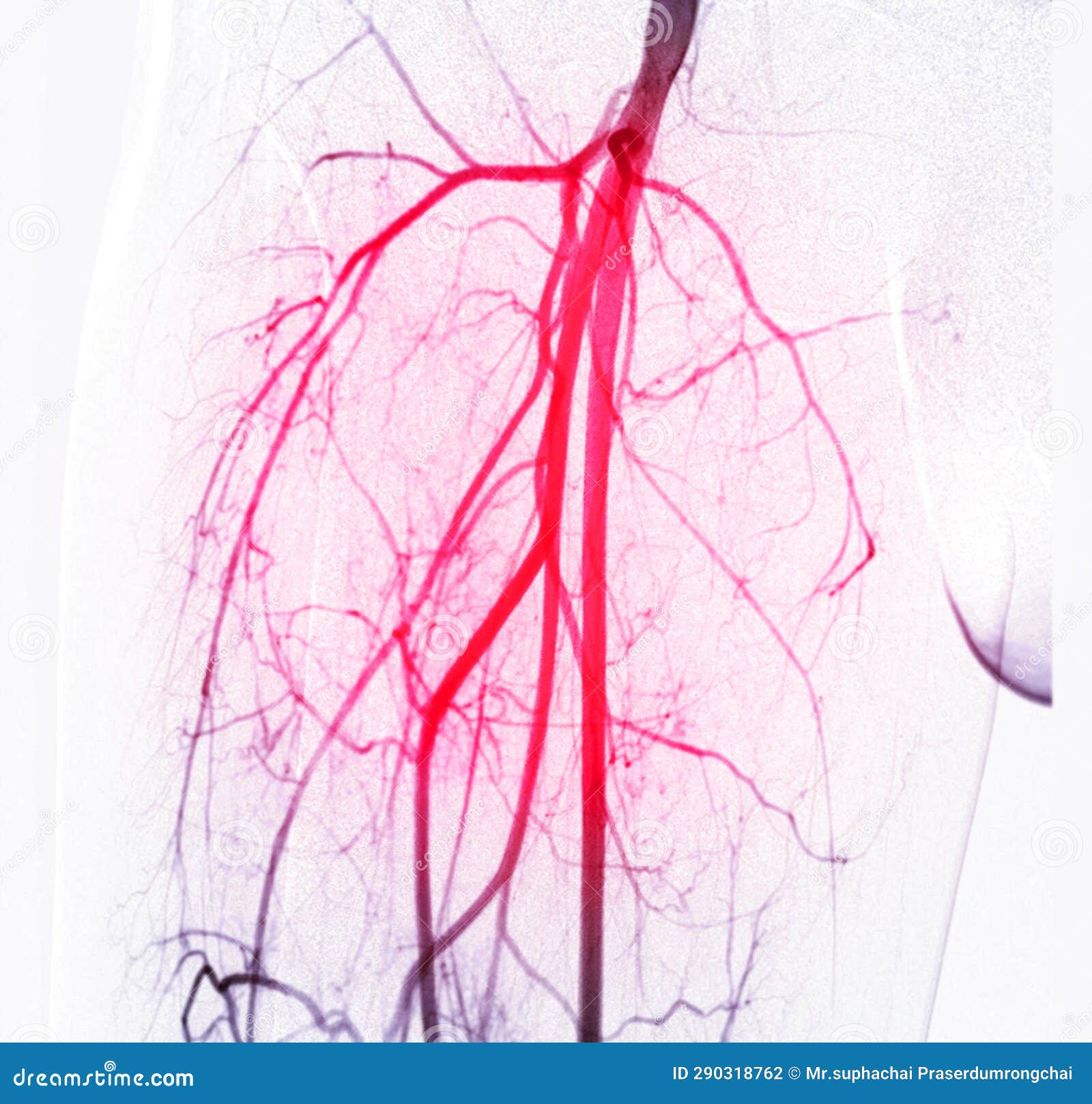Femoral Artery Angiogram or Angiography Stock Photo - Image of ...