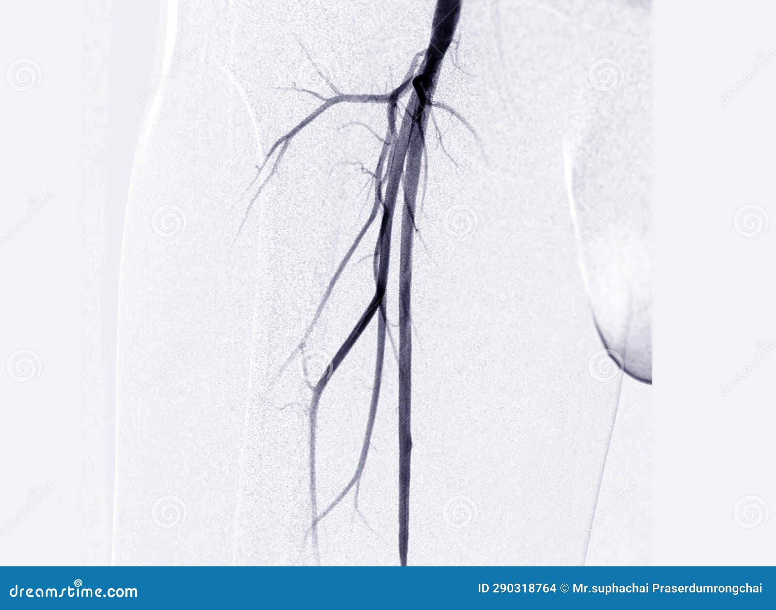 CTA Femoral Artery Run Off Showing Femoral Artery For Diagnostic Acute ...