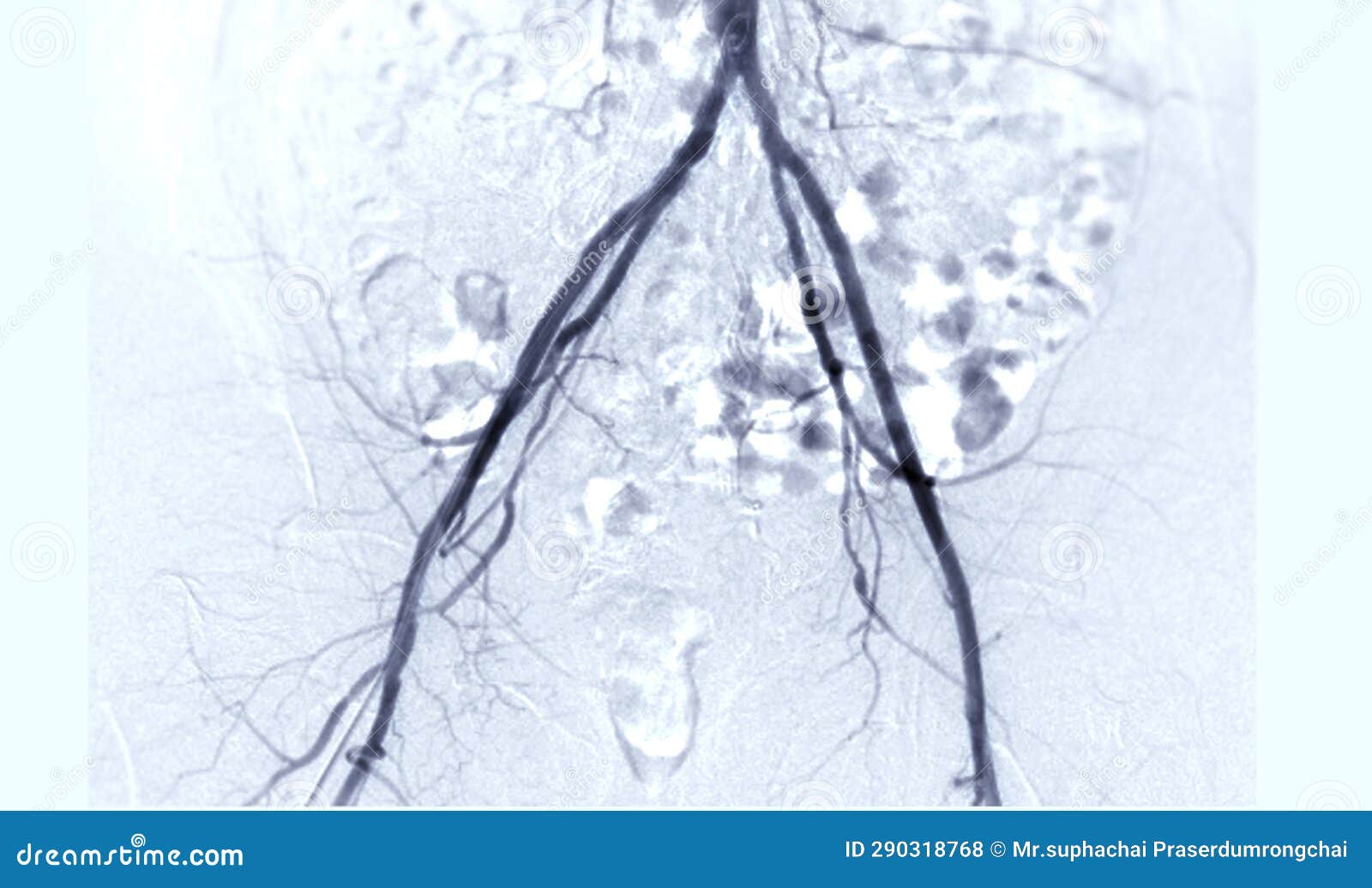 Femoral Artery Angiogram or Angiography Stock Photo - Image of arterial ...