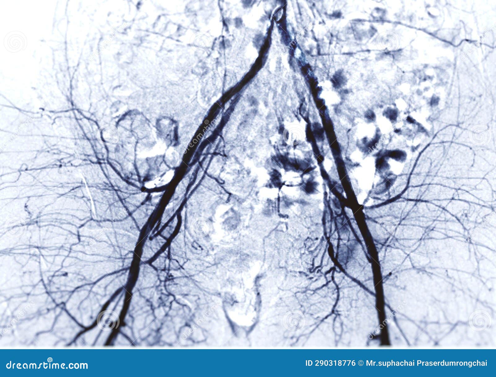 Femoral Artery Angiogram or Angiography Stock Photo - Image of media ...