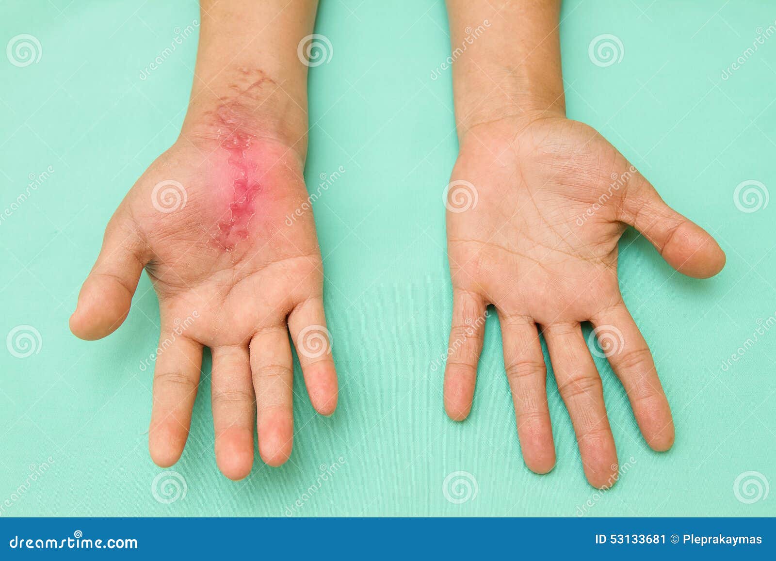 Ferida Da Cicatriz Em Mão Inchada E Inflamada Imagem de Stock - Imagem ...