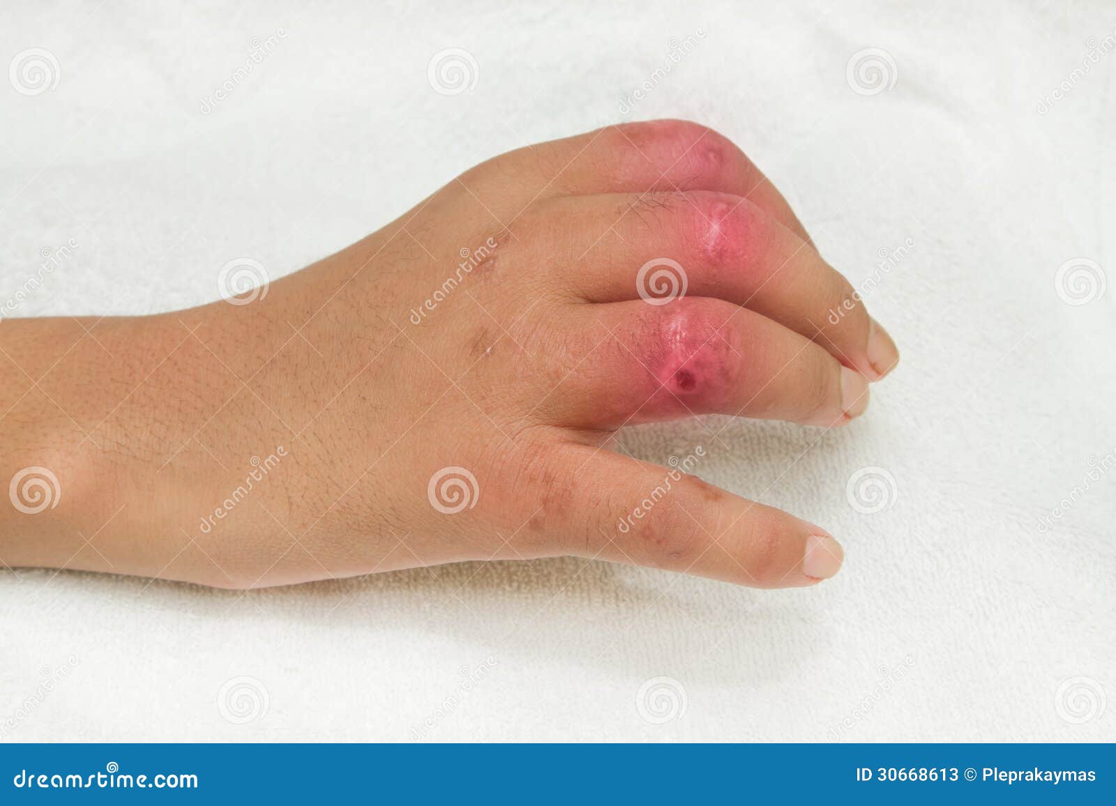 Ferida E Tratamento, Ferimento De Mão Imagem de Stock - Imagem de ...