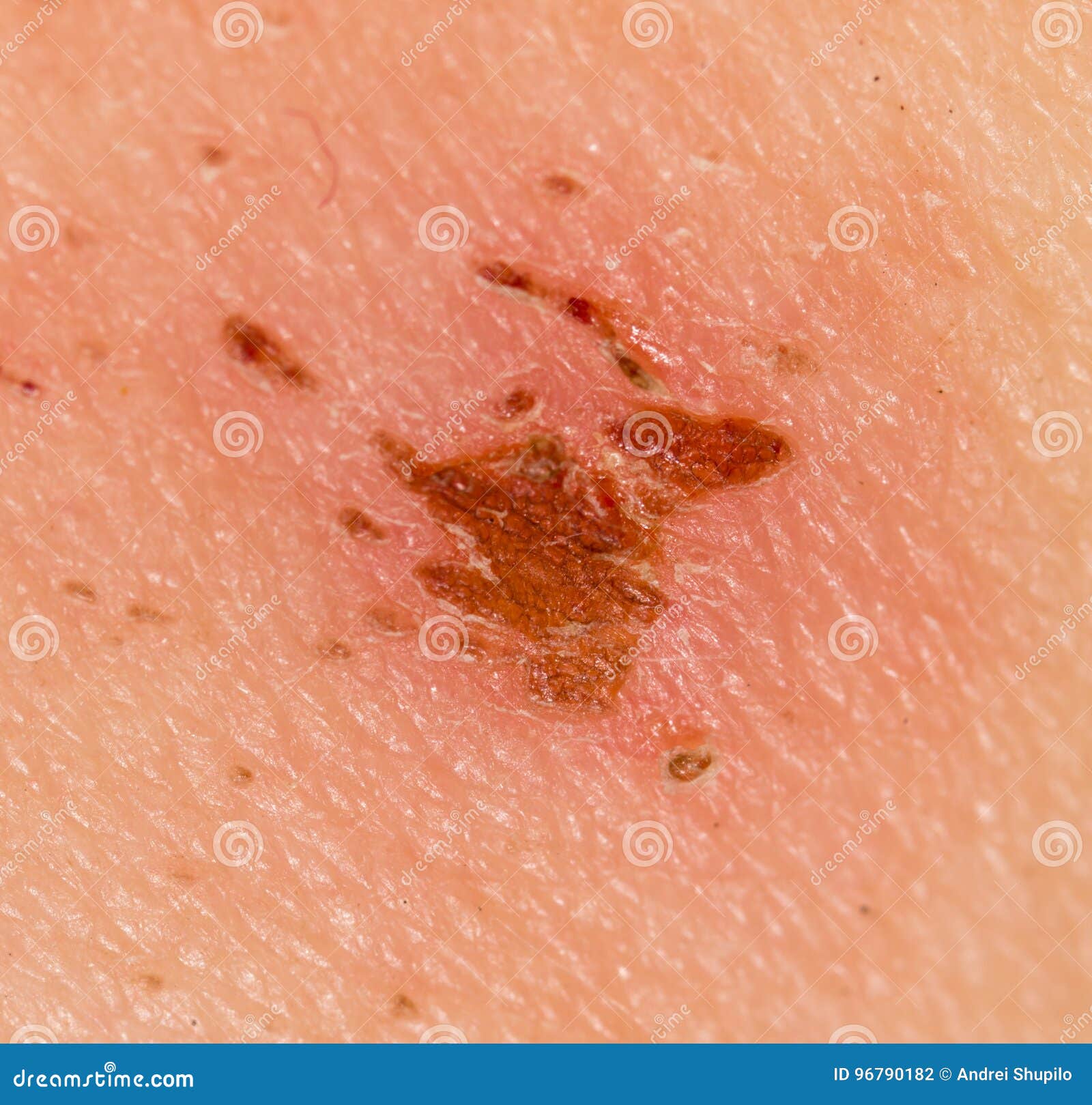 Ferida Na Pele De Uma Pessoa Foto de Stock - Imagem de povos, sangue ...