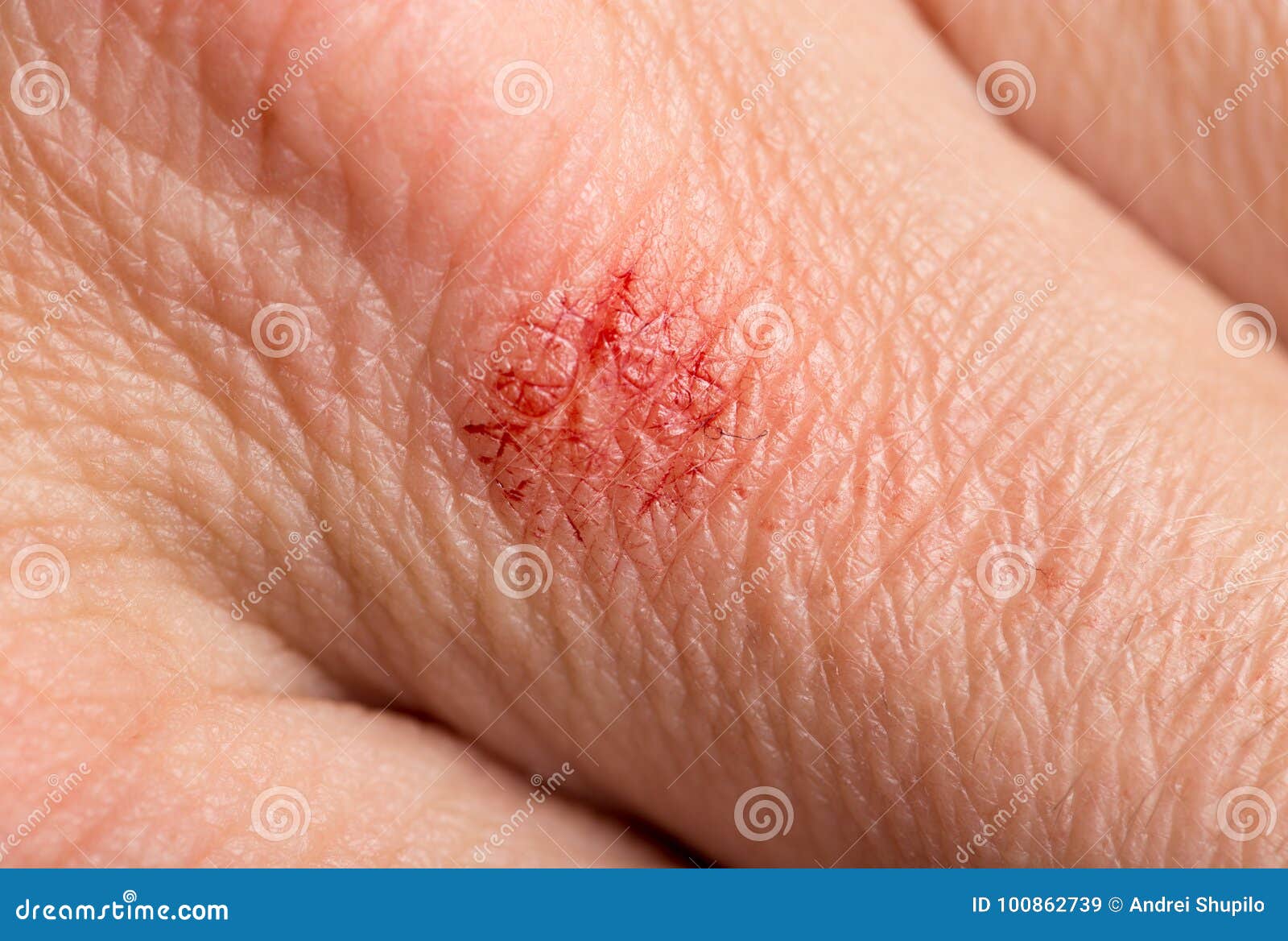 Ferida Na Pele Humana Macro Imagem de Stock - Imagem de lama, medicina ...