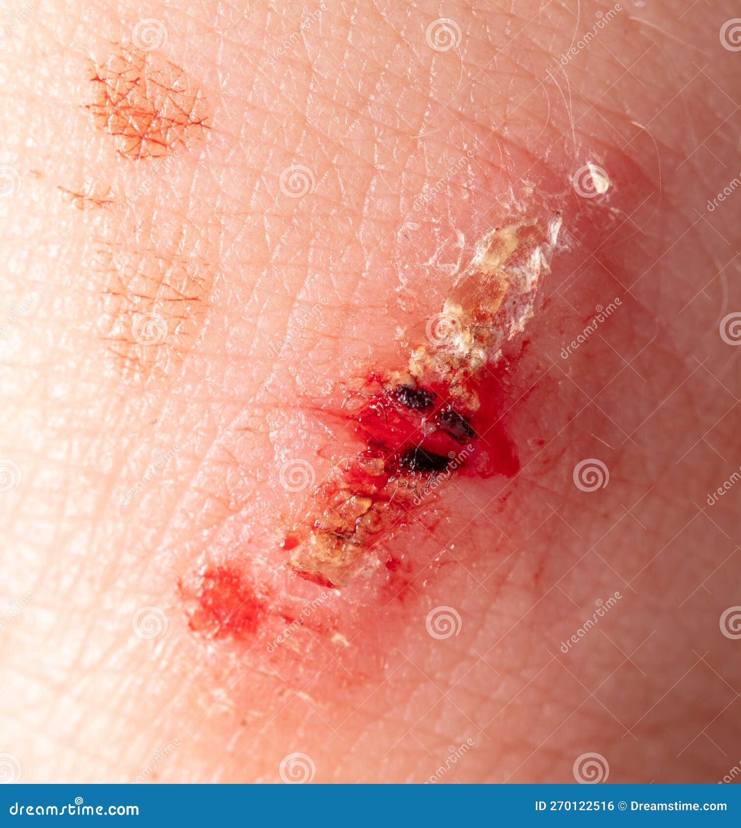 Ferida Na Pele Humana. Macro Foto de Stock - Imagem de textura, corte ...