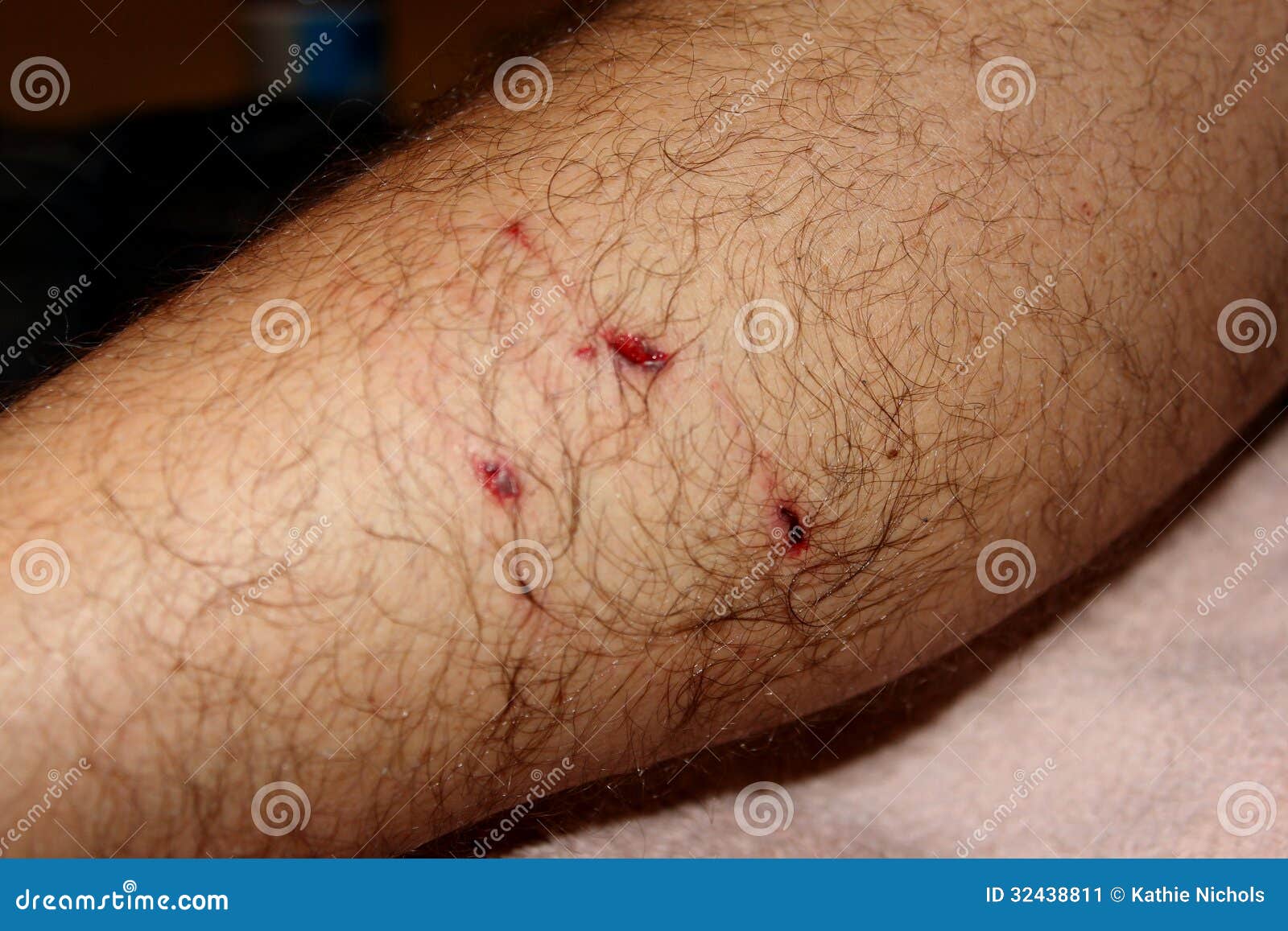 Ferita 1 del morso di cane immagine stock. Immagine di guastare - 32438811