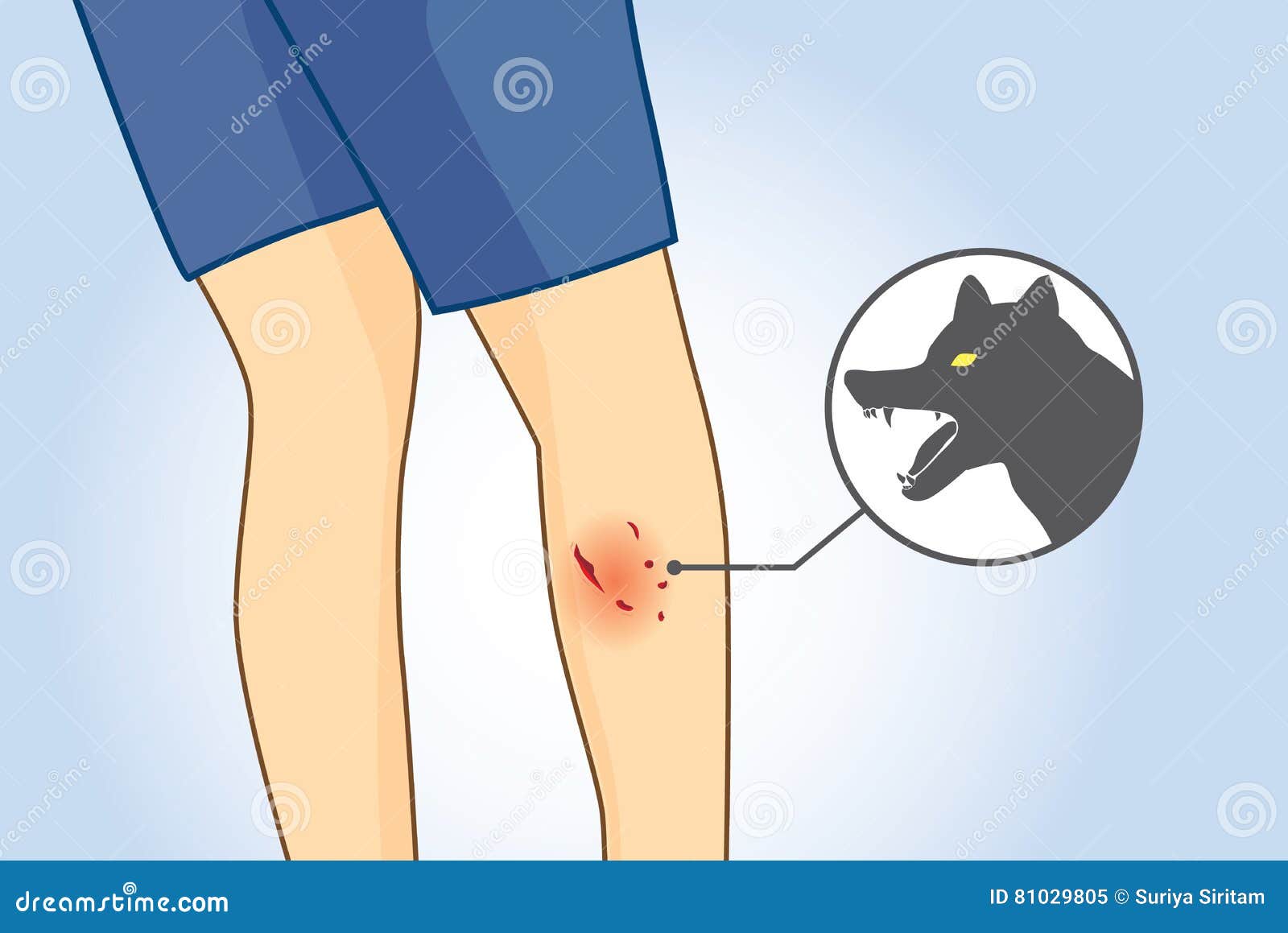 Ferite Del Morso Di Cane Sulla Gamba Del Vitello Illustrazione ...
