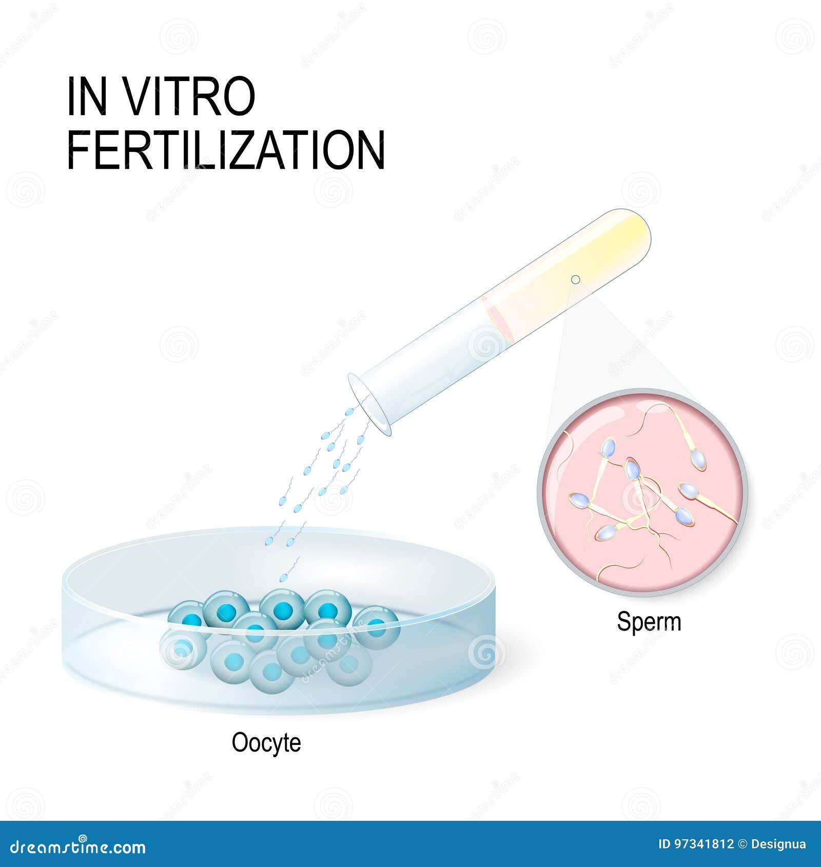 Fertilización in Vitro Inseminación Artificial Ilustración del Vector ...