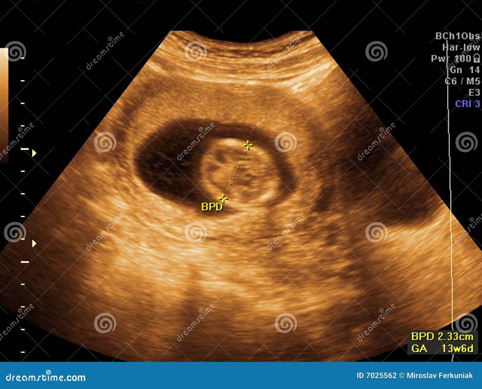 Fetus Sonogram stock photo. Image of baby, scan, fetus - 7025562
