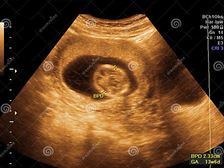 Fetus Sonogram stock photo. Image of baby, scan, fetus - 7025562