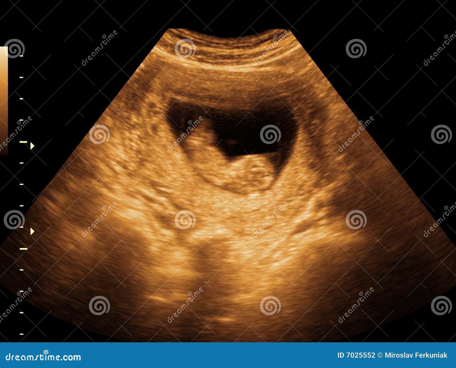 Fetus Ultrasound stock photo. Image of fertility, scan - 7025552