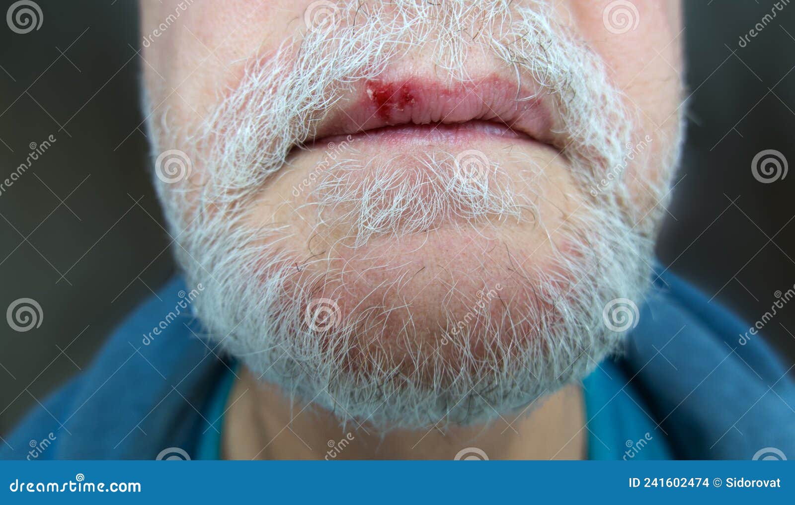 Fever Blister Caused by Herpes Simplex Virus on Upper Lip of Elderly ...