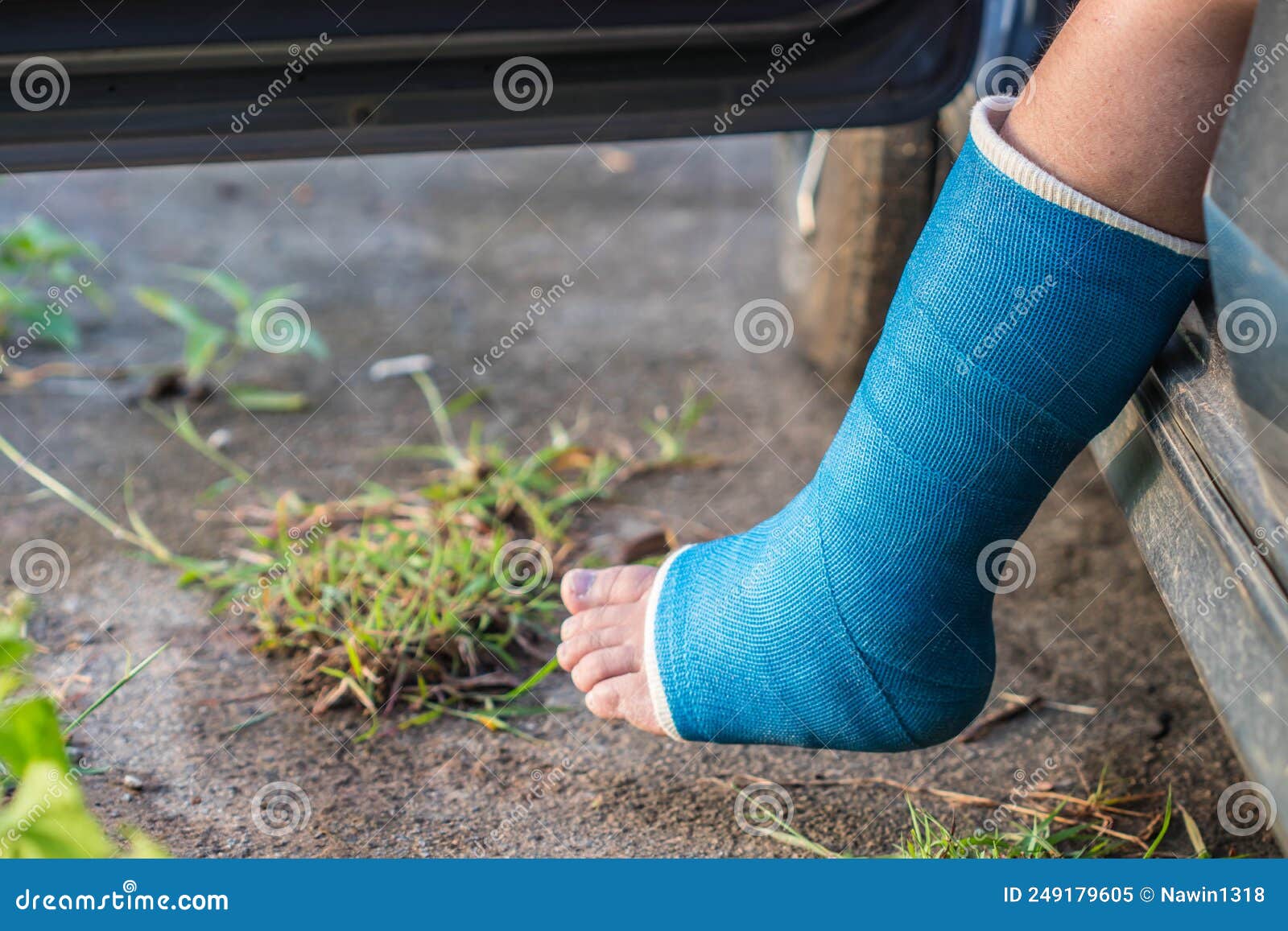 Fiber cast on left leg stock image. Image of hospital - 249179605