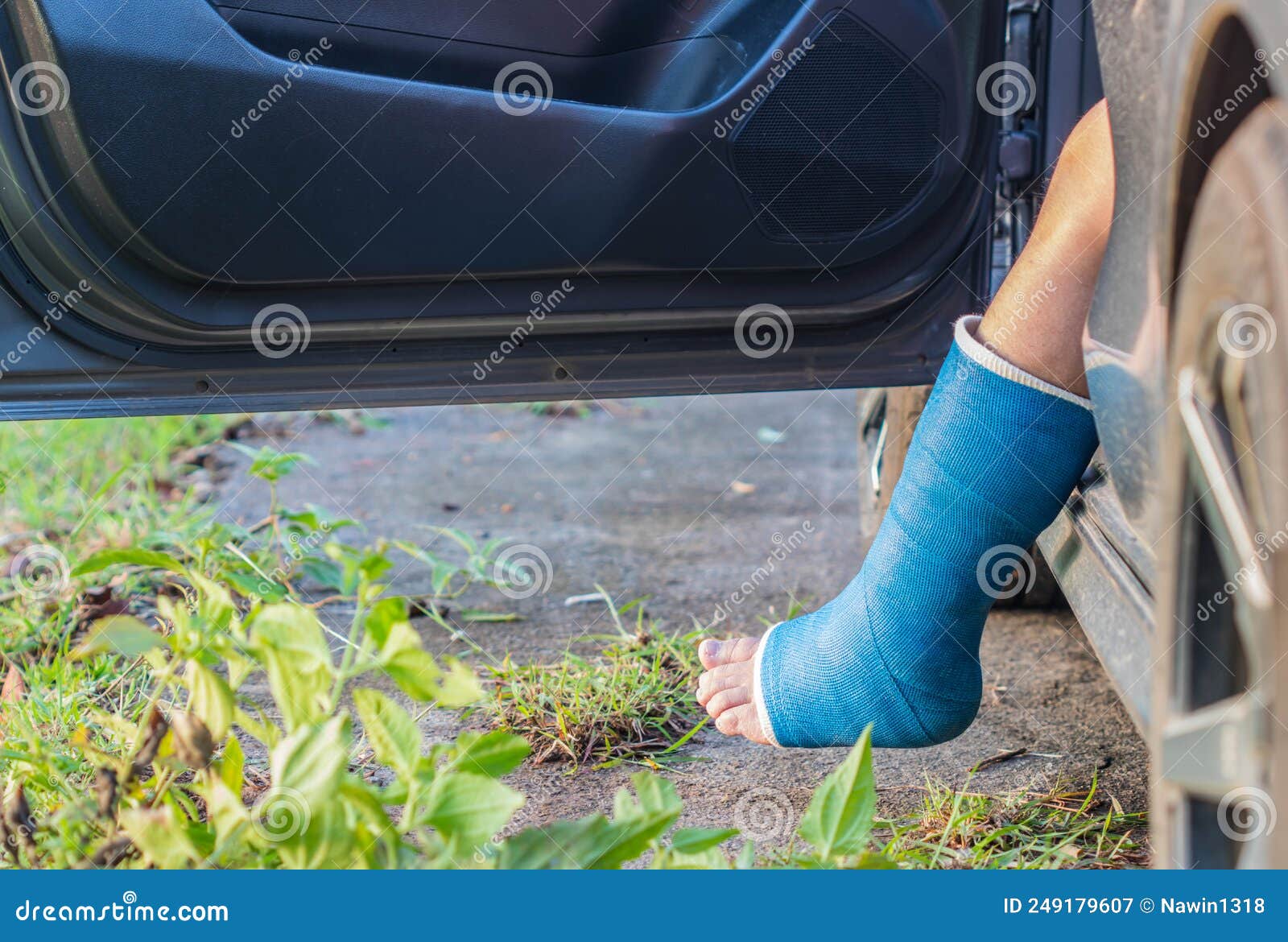 Fiber cast on left leg stock image. Image of conservative - 249179607