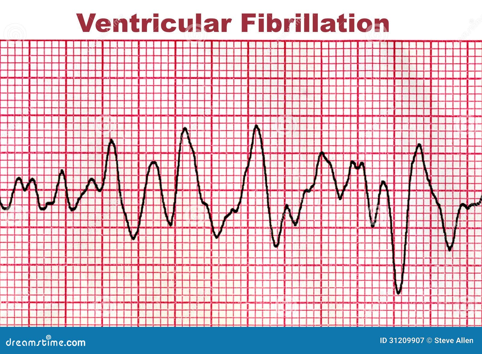Fibrillation Ventriculaire - Arythmie Mortelle De Coeur Image stock ...