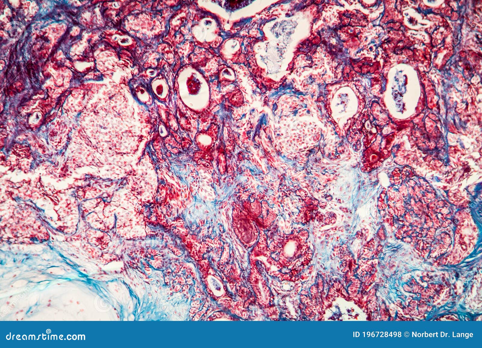 Fibroepithelium Diseased Tissue 100x Stock Photo - Image of gland ...