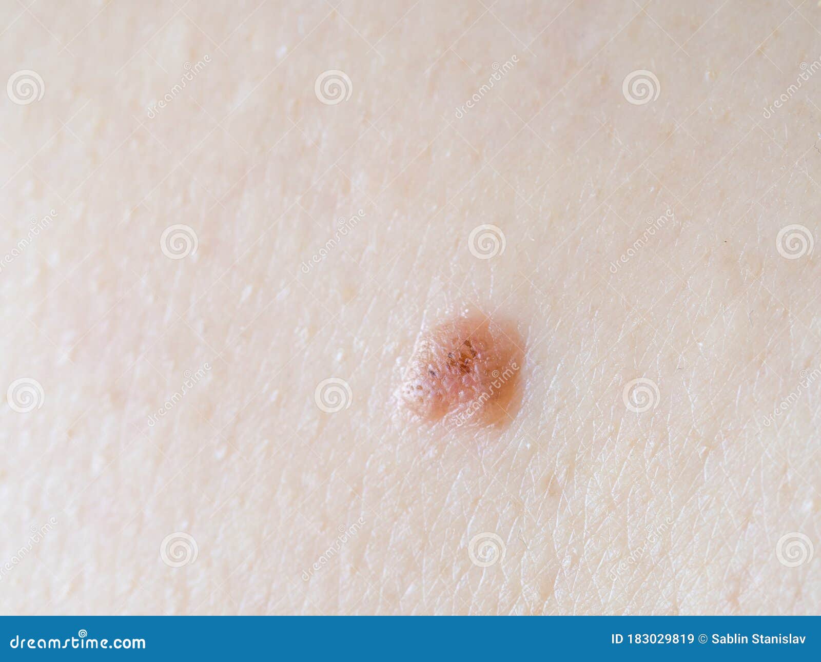 Fibroma on Human Skin, Close Up Stock Image - Image of cancer, body ...