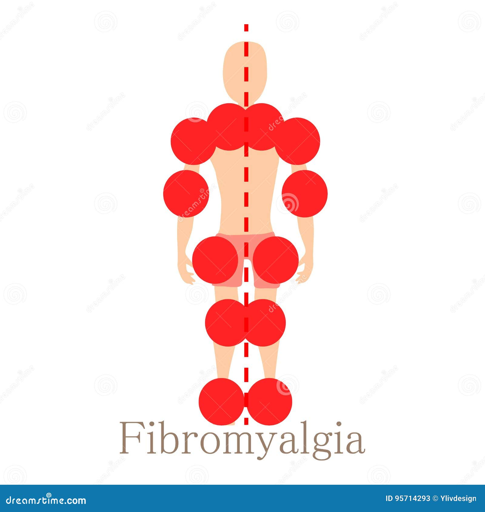 Fibromyalgia Vector Illustration. Diagnosis Symptoms Labeled Diagram ...