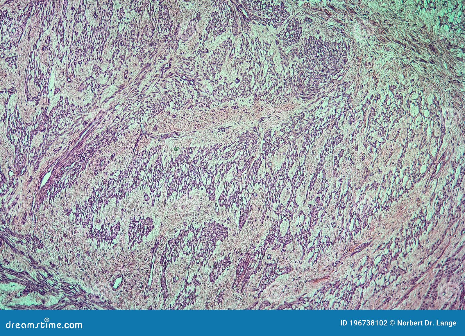 Fibromyoma of the Uterus Diseased Tissue Stock Photo - Image of cells ...