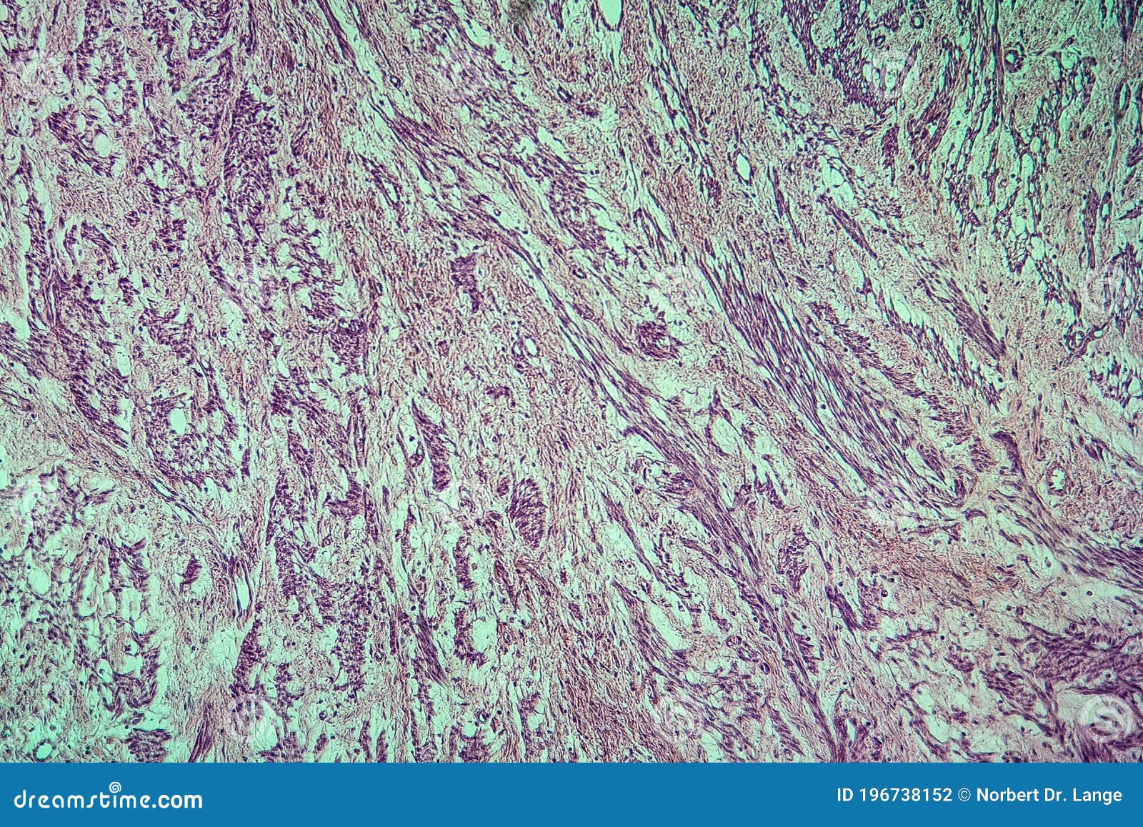 Fibromyoma of the Uterus Diseased Tissue Stock Photo - Image of growth ...