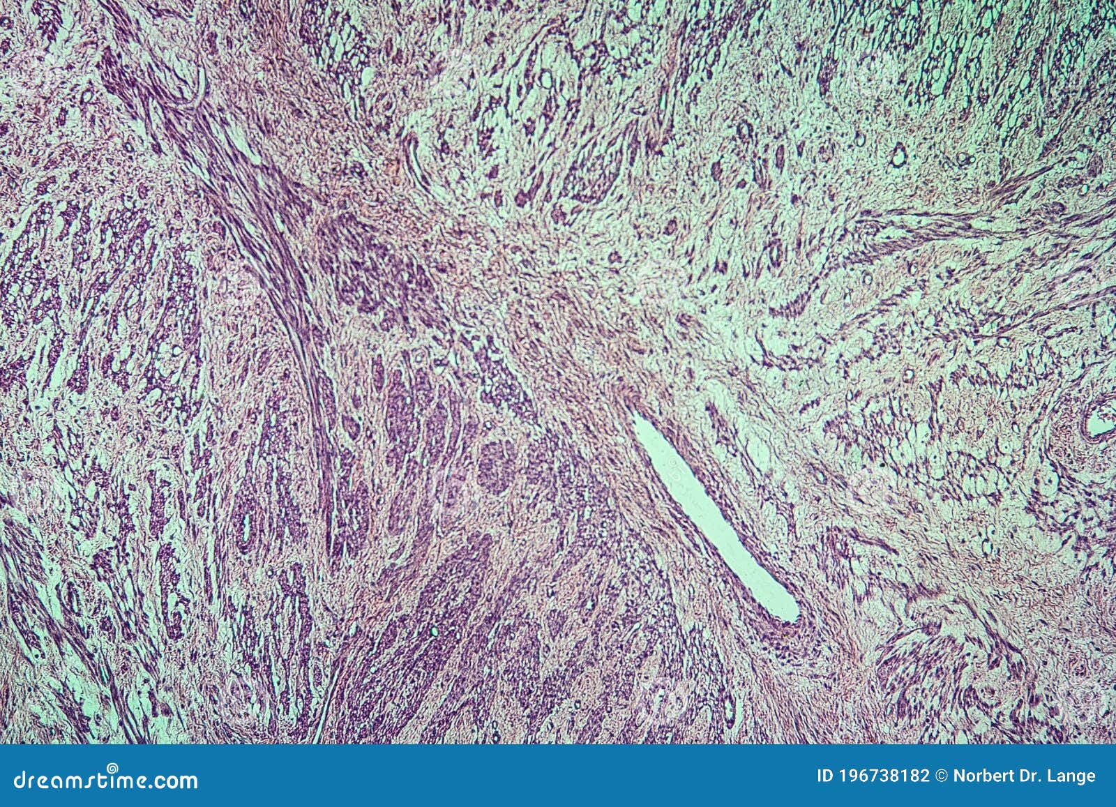 Fibromyoma of the Uterus Diseased Tissue Stock Photo - Image of ...