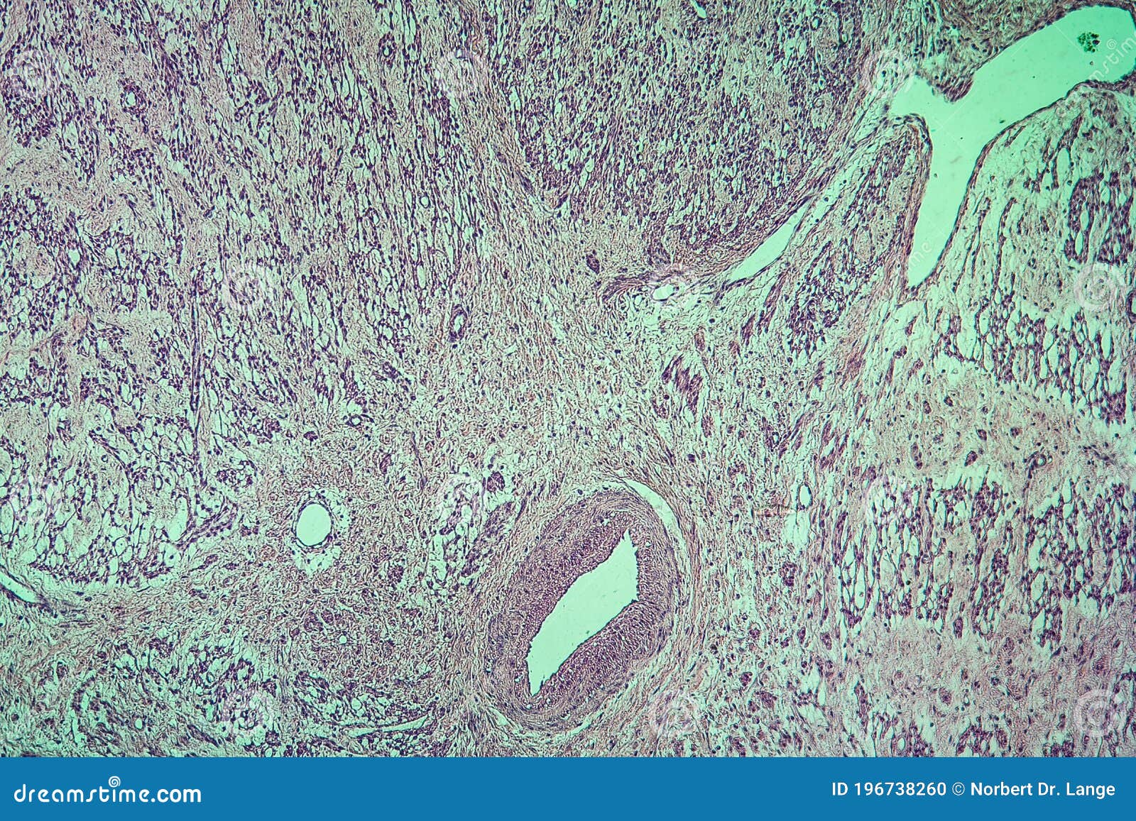 Fibromyoma of the Uterus Diseased Tissue Stock Photo - Image of ...