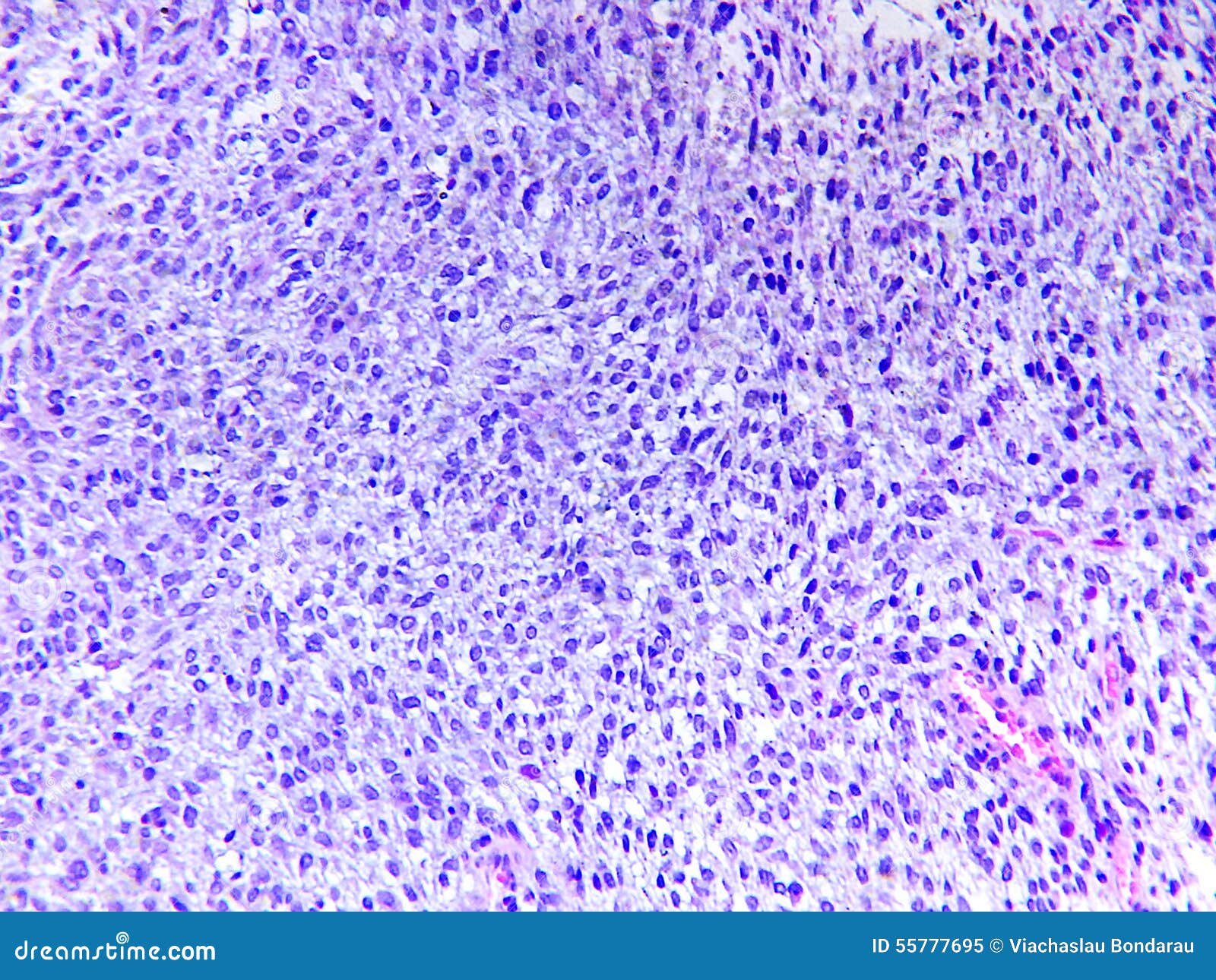 Fibrosarcoma of a human stock image. Image of medicine - 55777695