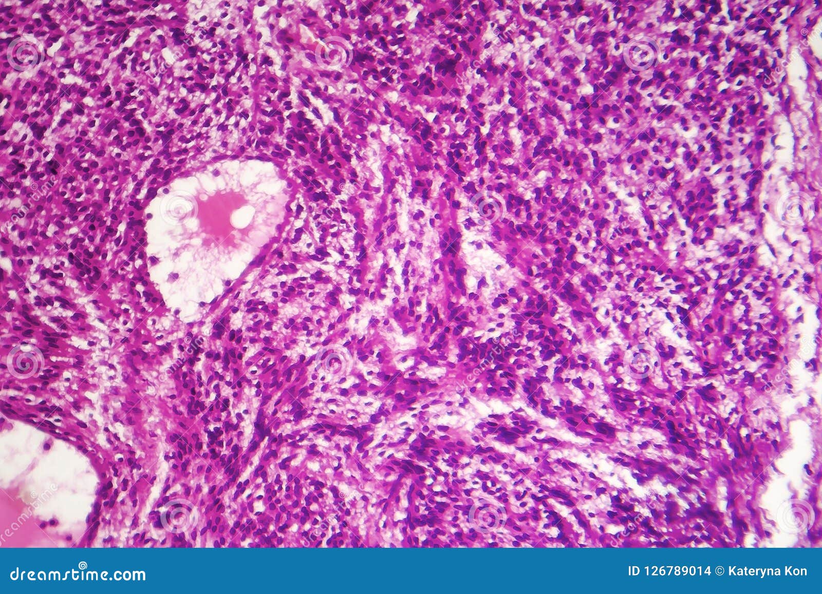 Fibrosarcoma, Light Micrograph Stock Photo | CartoonDealer.com #291824052