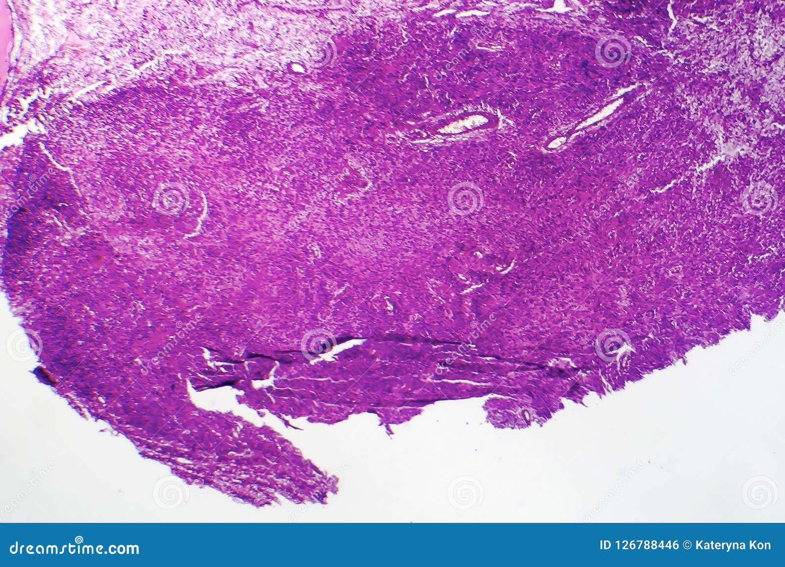 Fibrosarcoma, Tumor Malo De Fibroblastos Foto de archivo - Imagen de ...