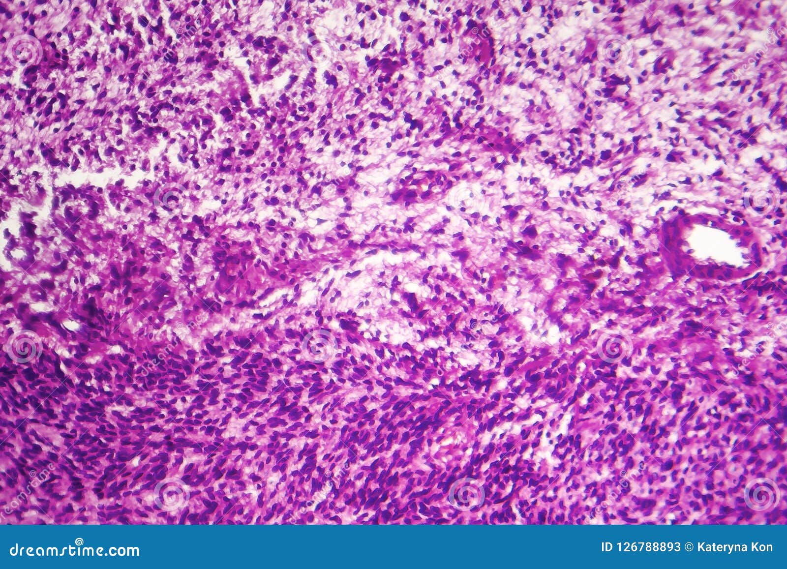 Fibrosarcoma, Tumor Malo De Fibroblastos Imagen de archivo - Imagen de ...