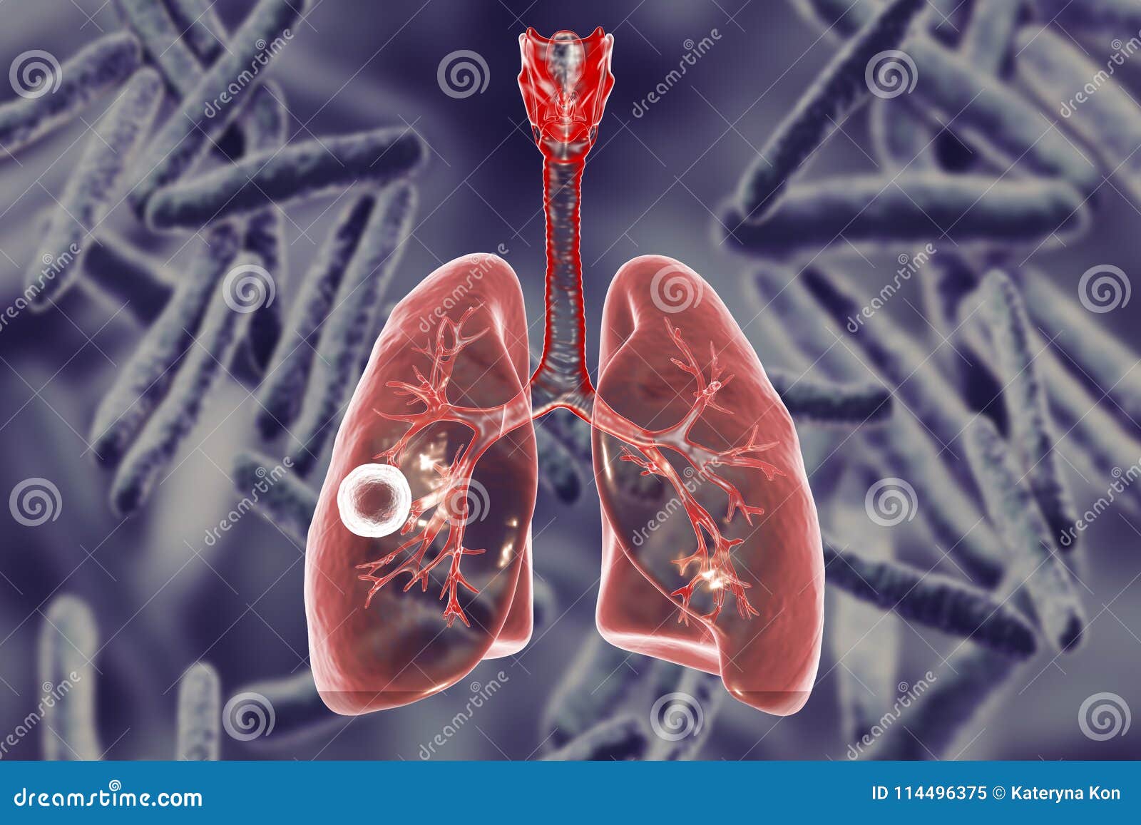Fibrous-cavernous Pulmonary Tuberculosis Stock Illustration ...