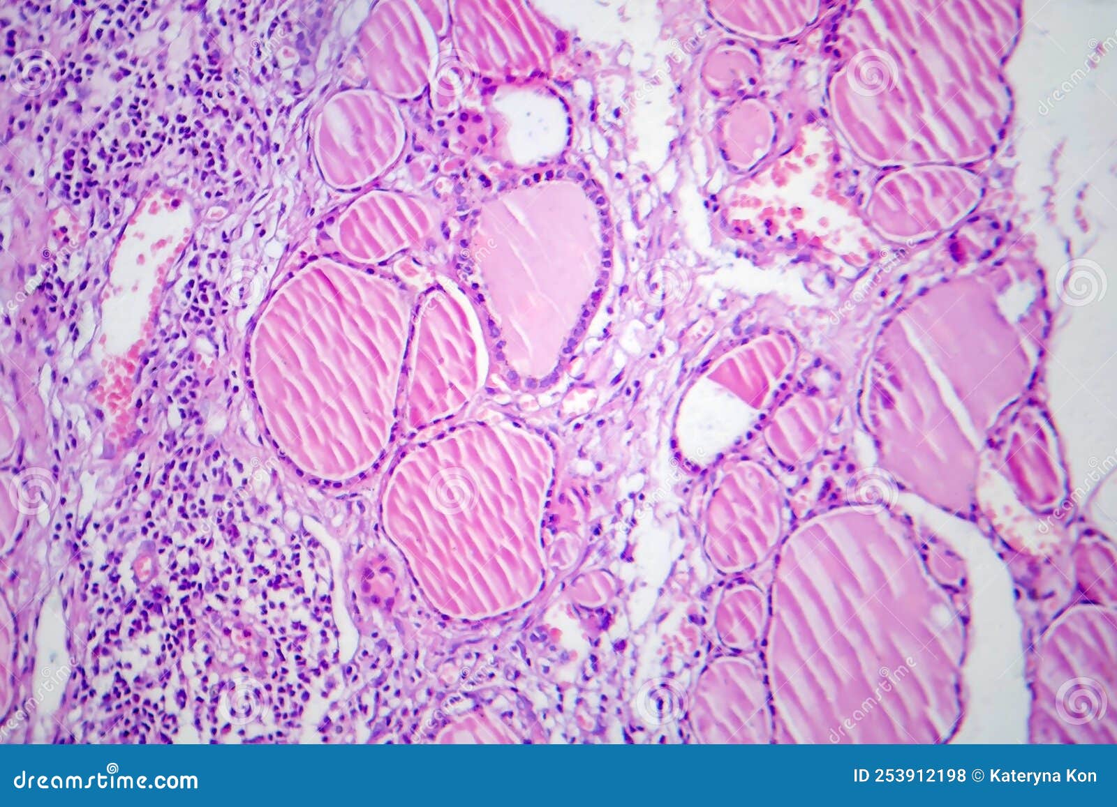 Fibrous Thyroiditis, Light Micrograph Stock Photo - Image of stain ...