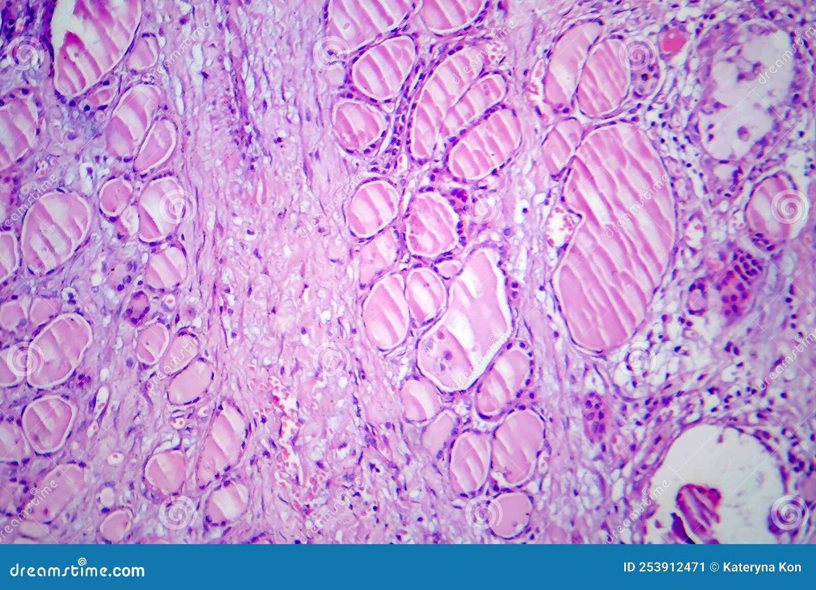Fibrous Thyroiditis, Light Micrograph Stock Image | CartoonDealer.com ...