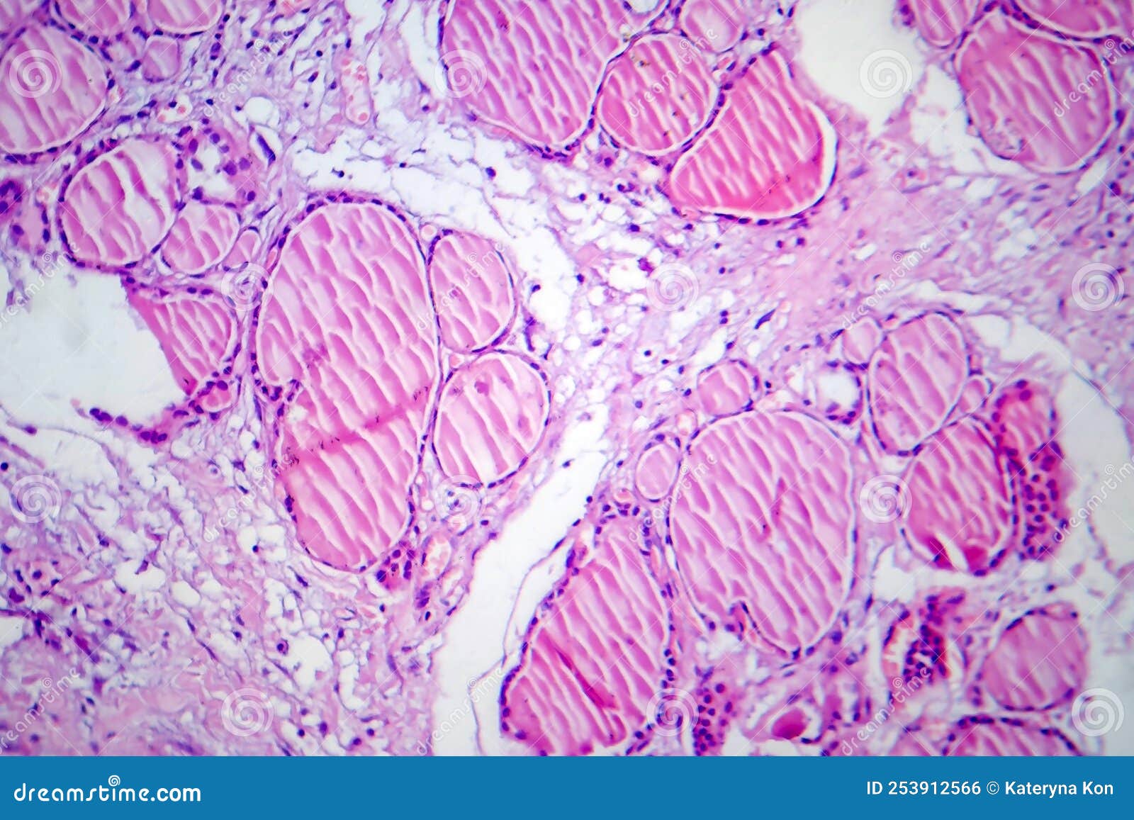 Fibrous Thyroiditis, Light Micrograph Stock Photo - Image of illness ...