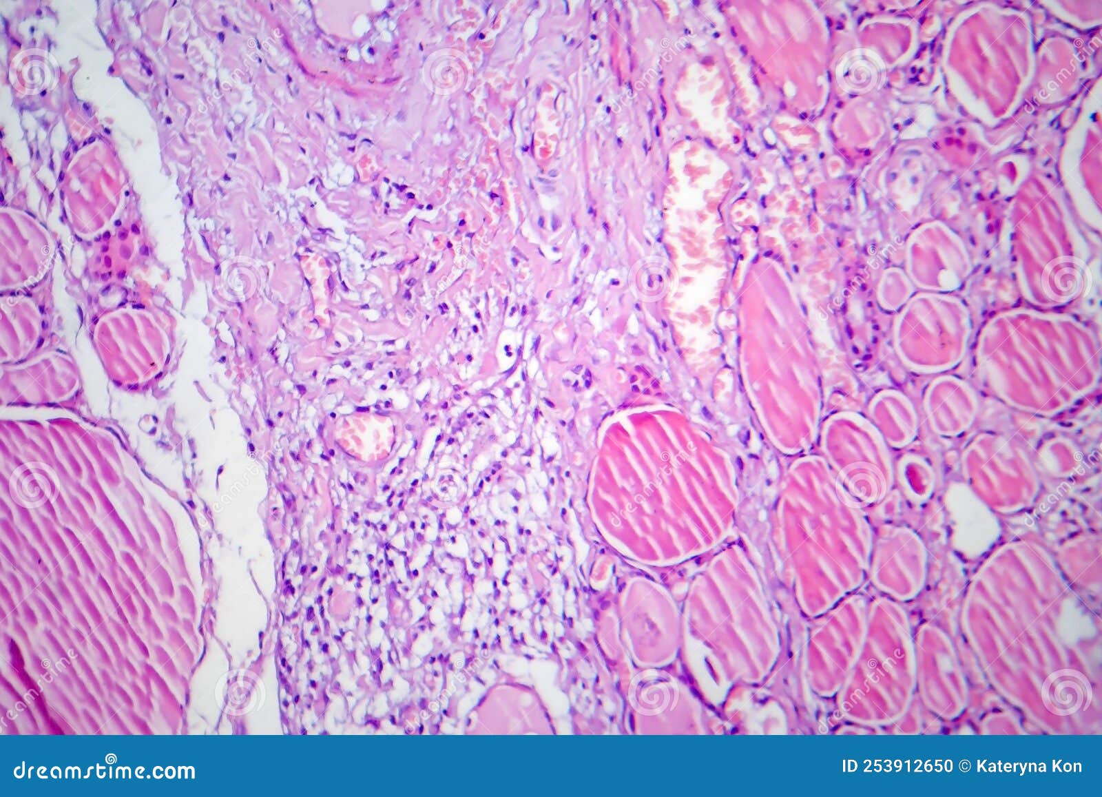 Fibrous Thyroiditis, Light Micrograph Stock Photo - Image of ...