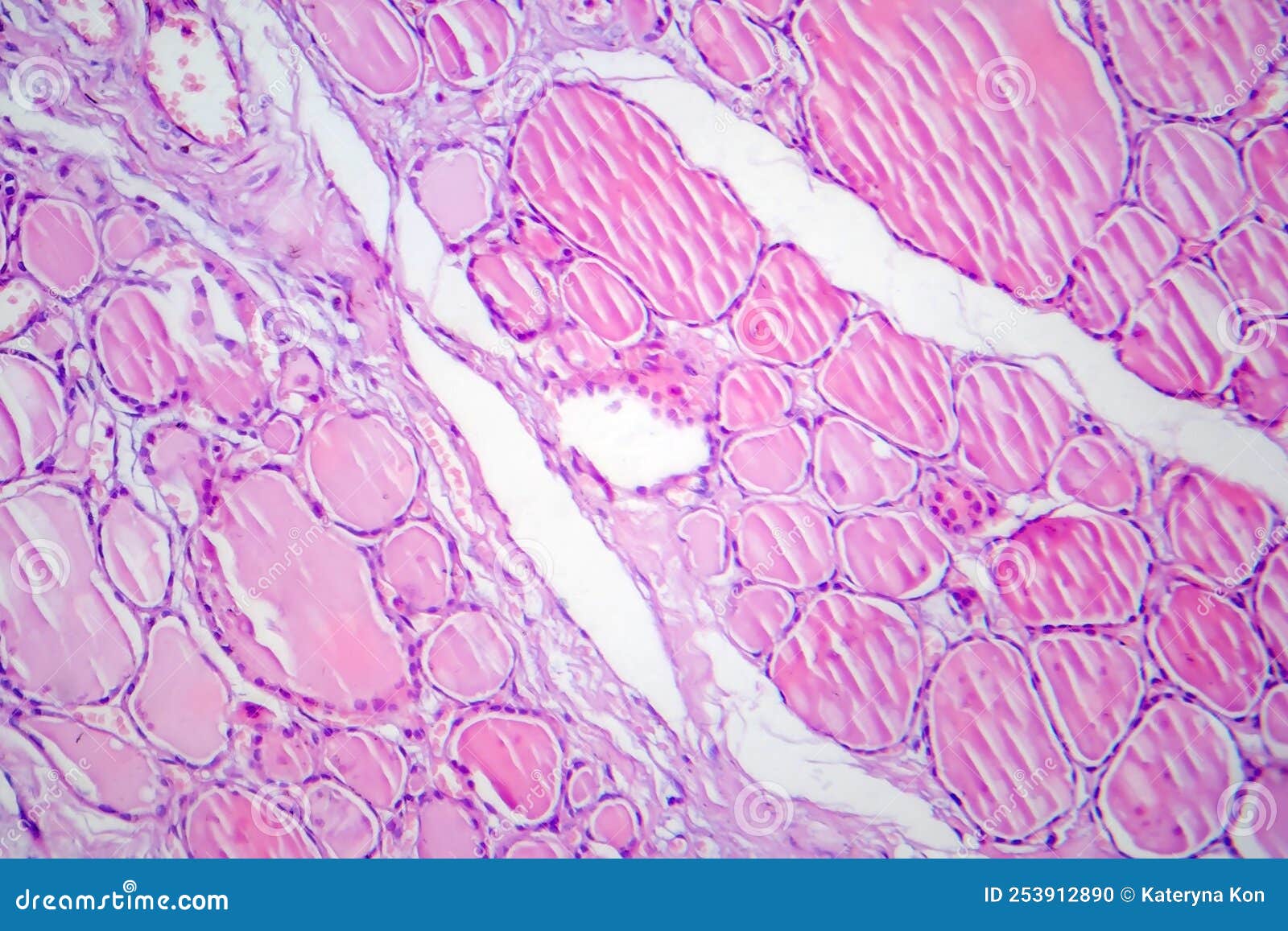 Fibrous Thyroiditis, Light Micrograph Stock Photo - Image of fibrosis ...