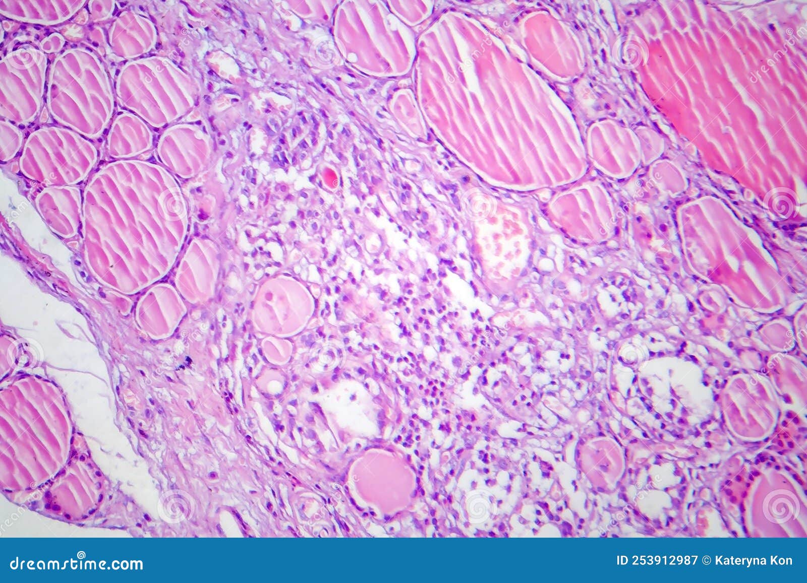 Fibrous Thyroiditis, Light Micrograph Stock Image - Image of medicine ...