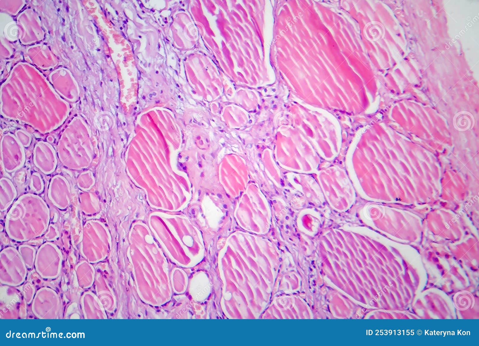 Fibrous Thyroiditis, Light Micrograph Stock Image | CartoonDealer.com ...