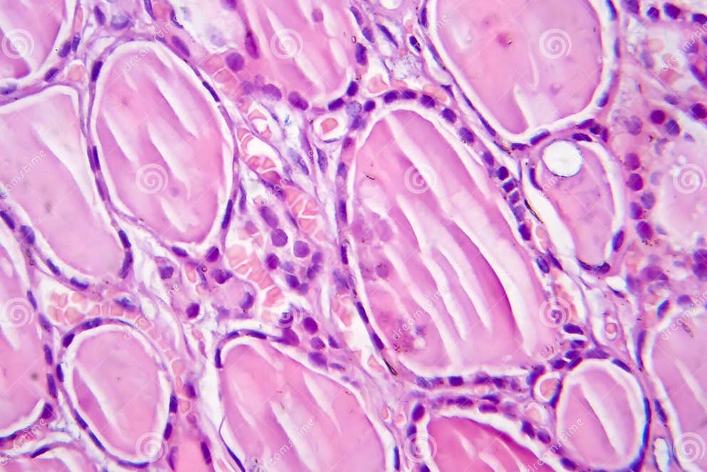 Fibrous Thyroiditis, Light Micrograph Stock Image - Image of ...