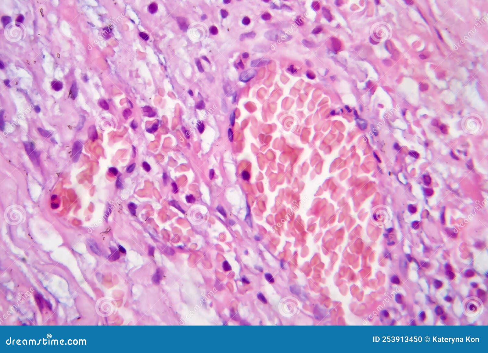 Fibrous Thyroiditis, Light Micrograph Stock Photography | CartoonDealer ...
