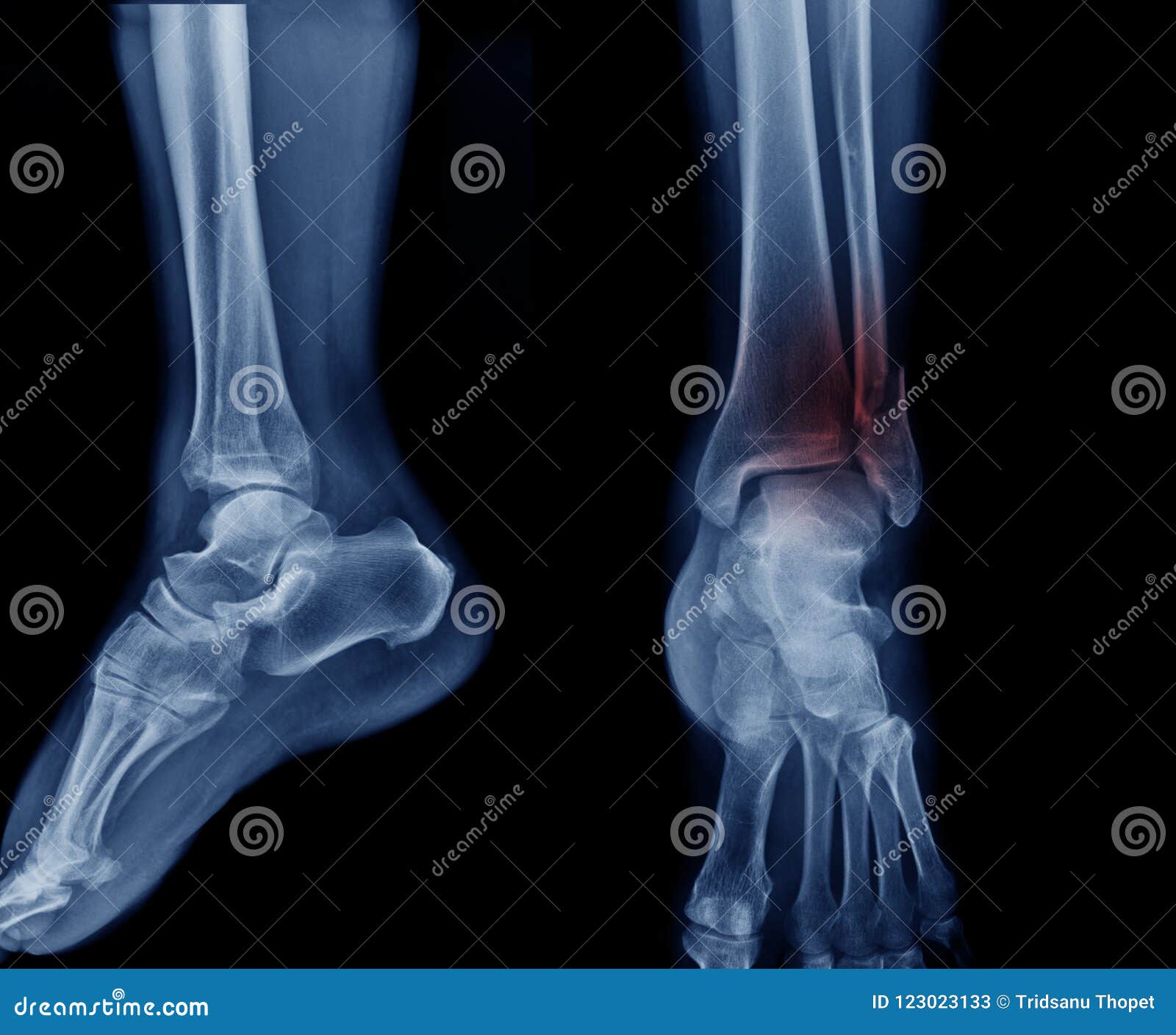 Fibular bone fracture stock image. Image of person, diagnosis - 123023133