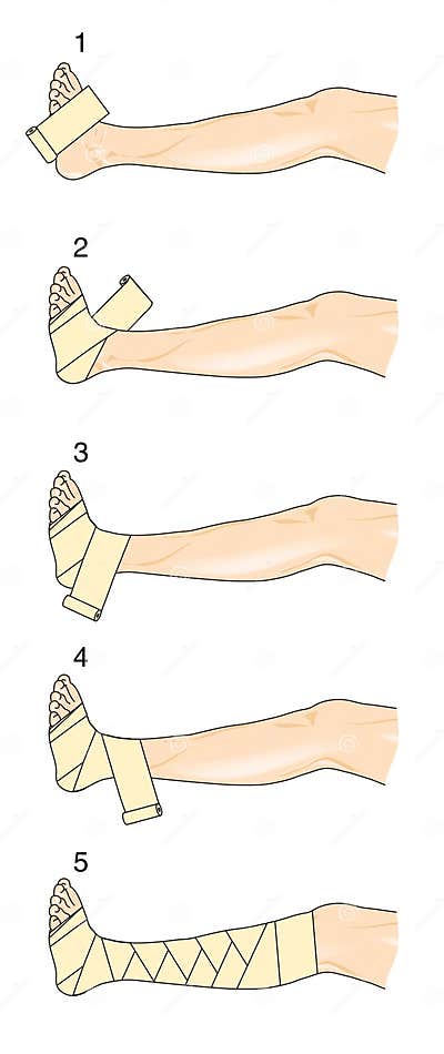 Figure of Eight Leg Bandage Stock Vector - Illustration of eight, bone ...