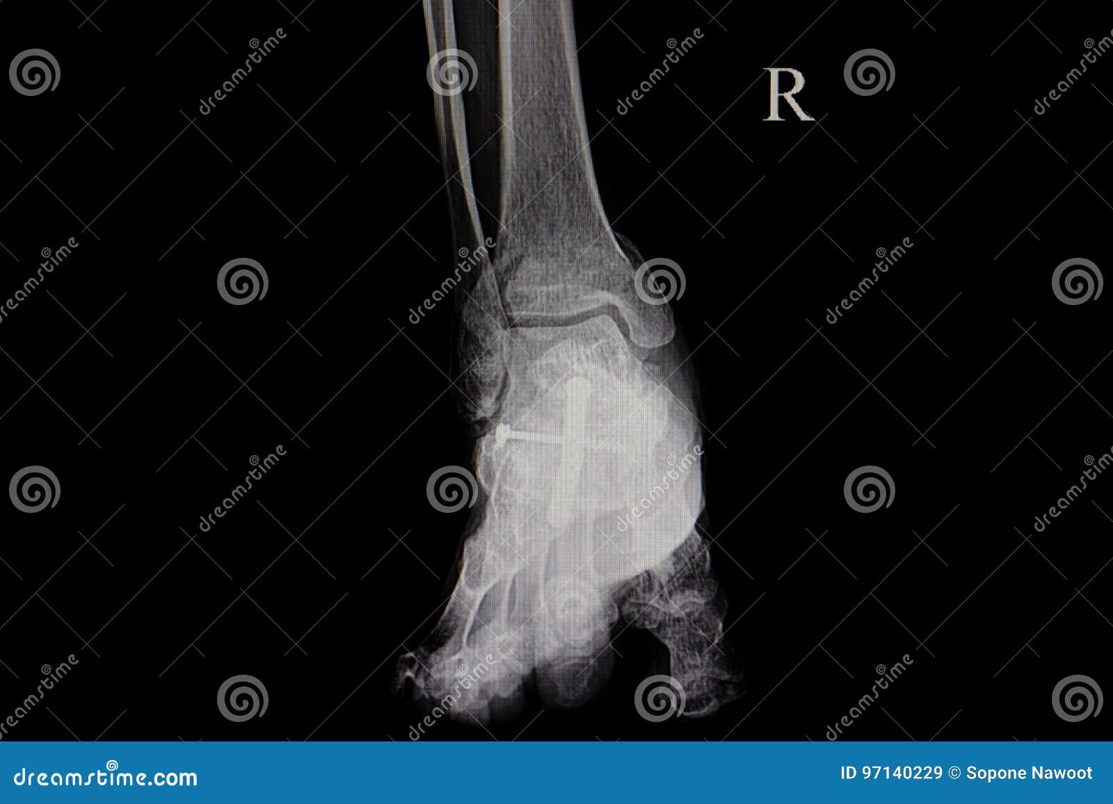 Film foot stock image. Image of doctor, radiation, human - 97140229