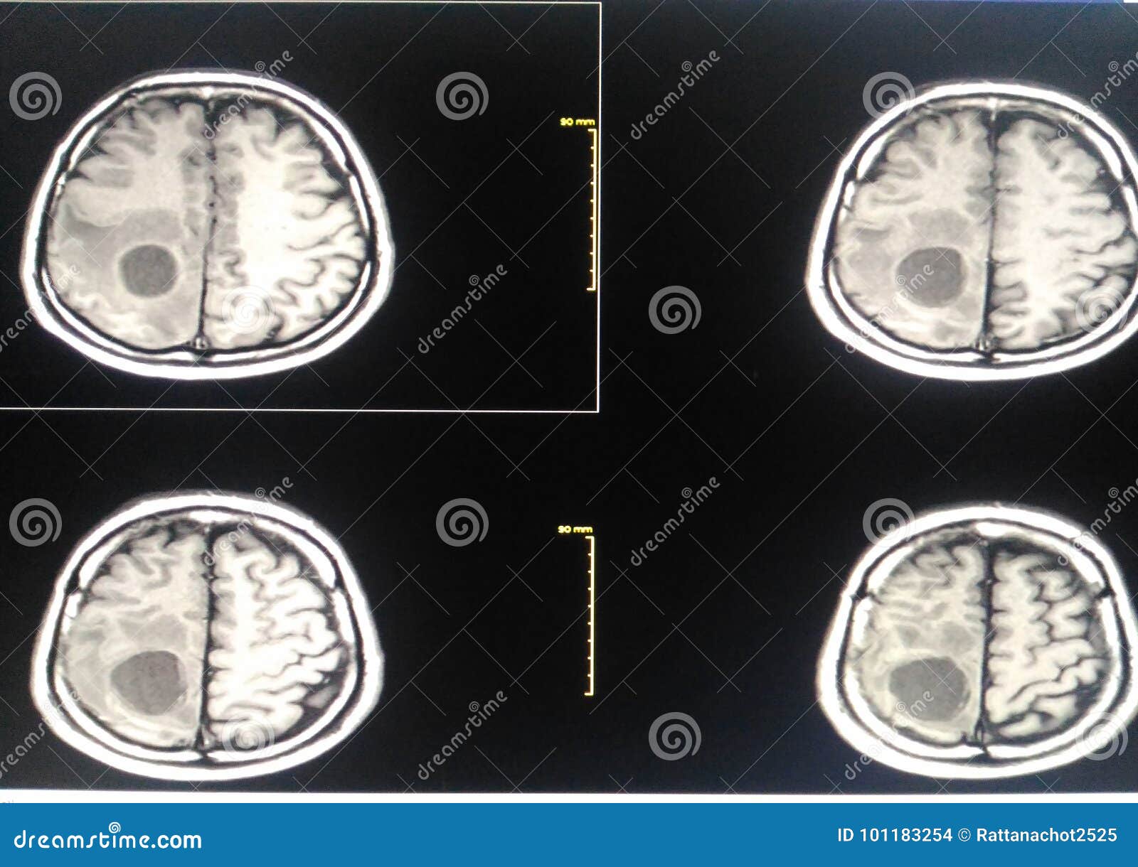 Film MRI. Brain stock photo. Image of coin, font, product - 101183254