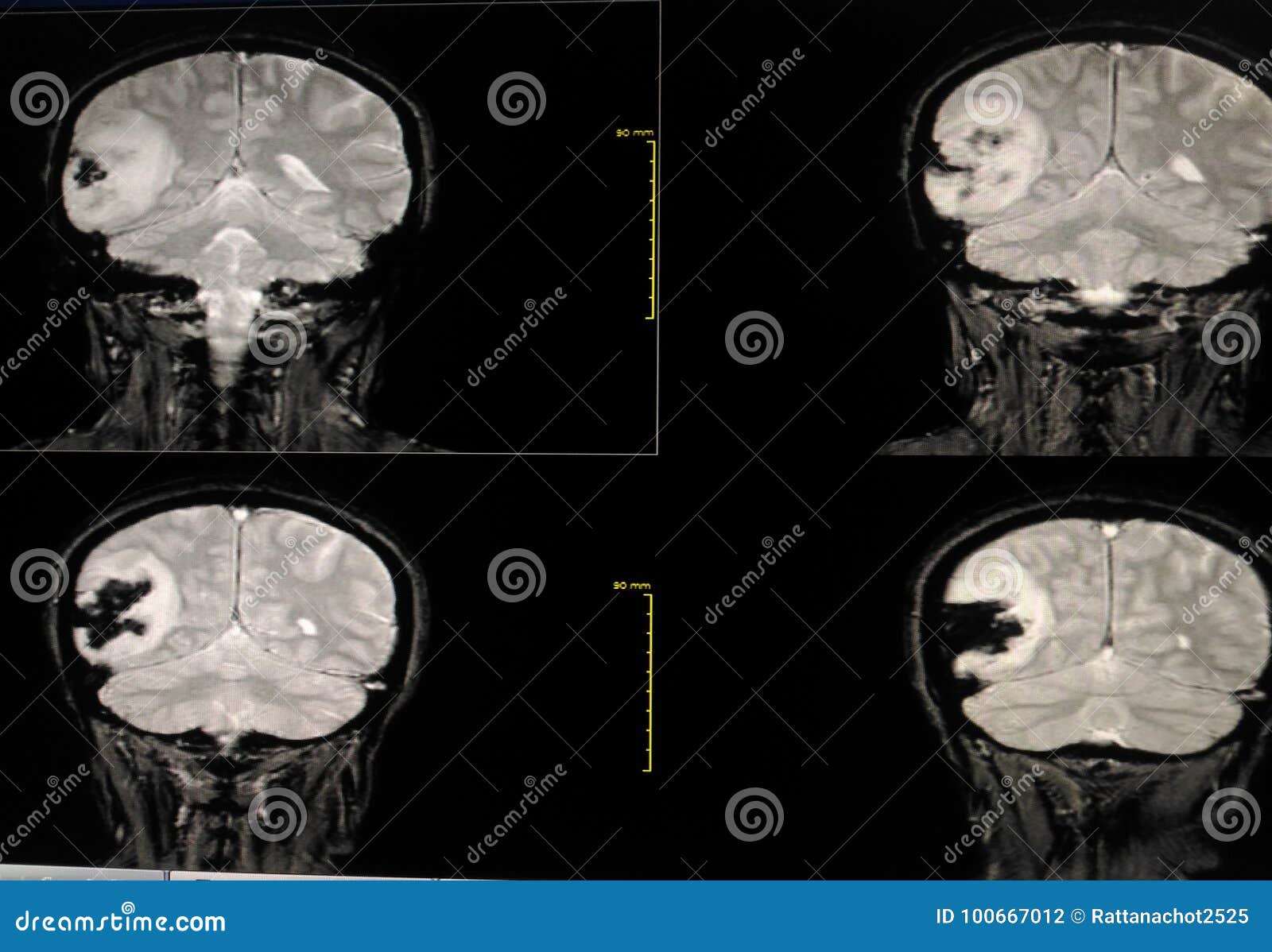MRI Brain. stock photo. Image of face, radiology, radiography - 100667012