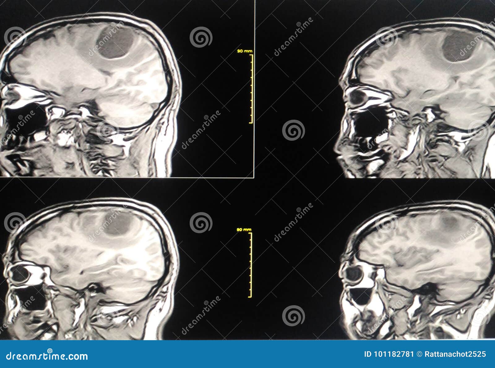 Film MRI. Brain stock illustration. Illustration of organ - 101182781