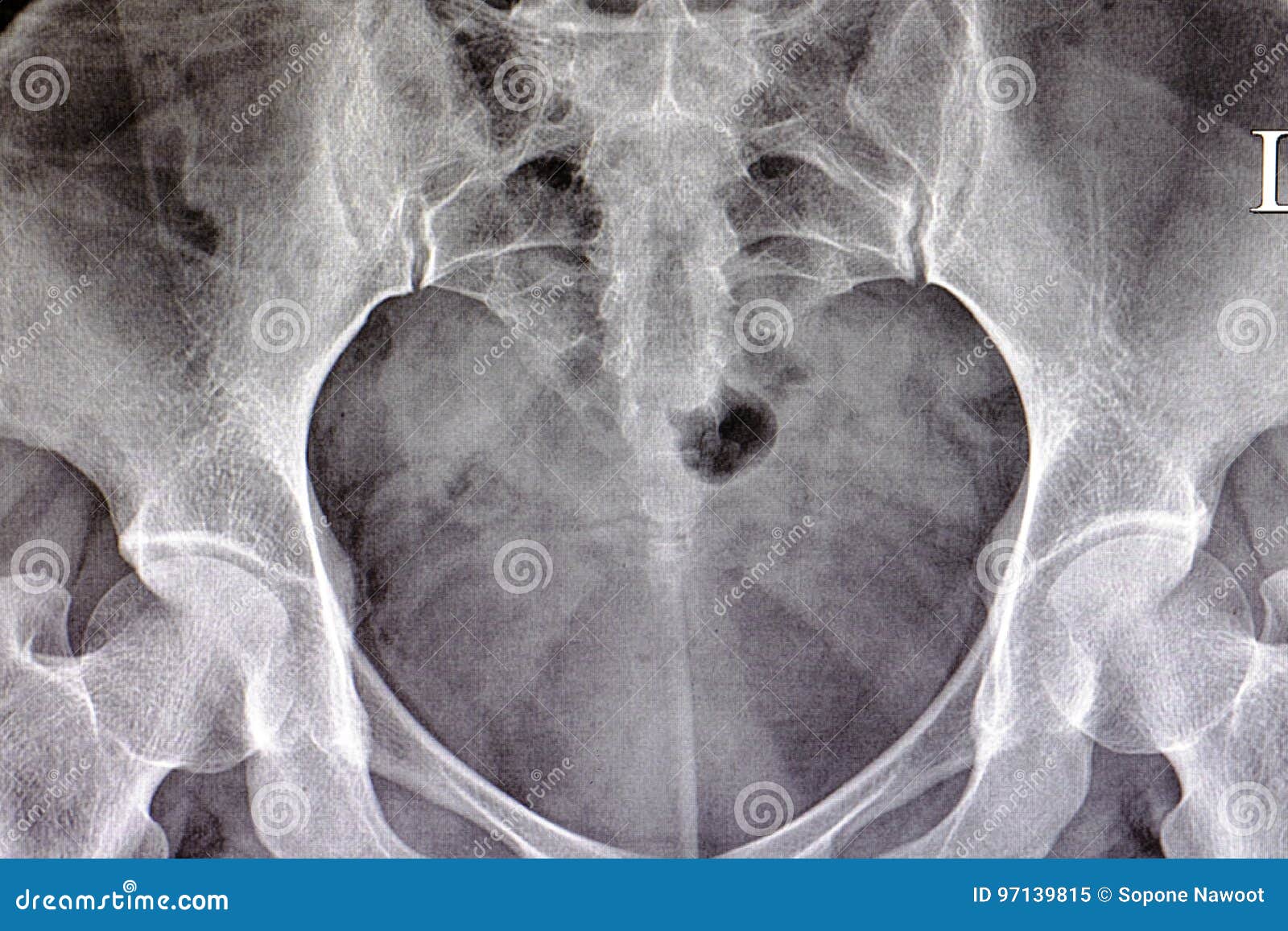 Film pelvis stock image. Image of skeleton, xray, examination - 97139815