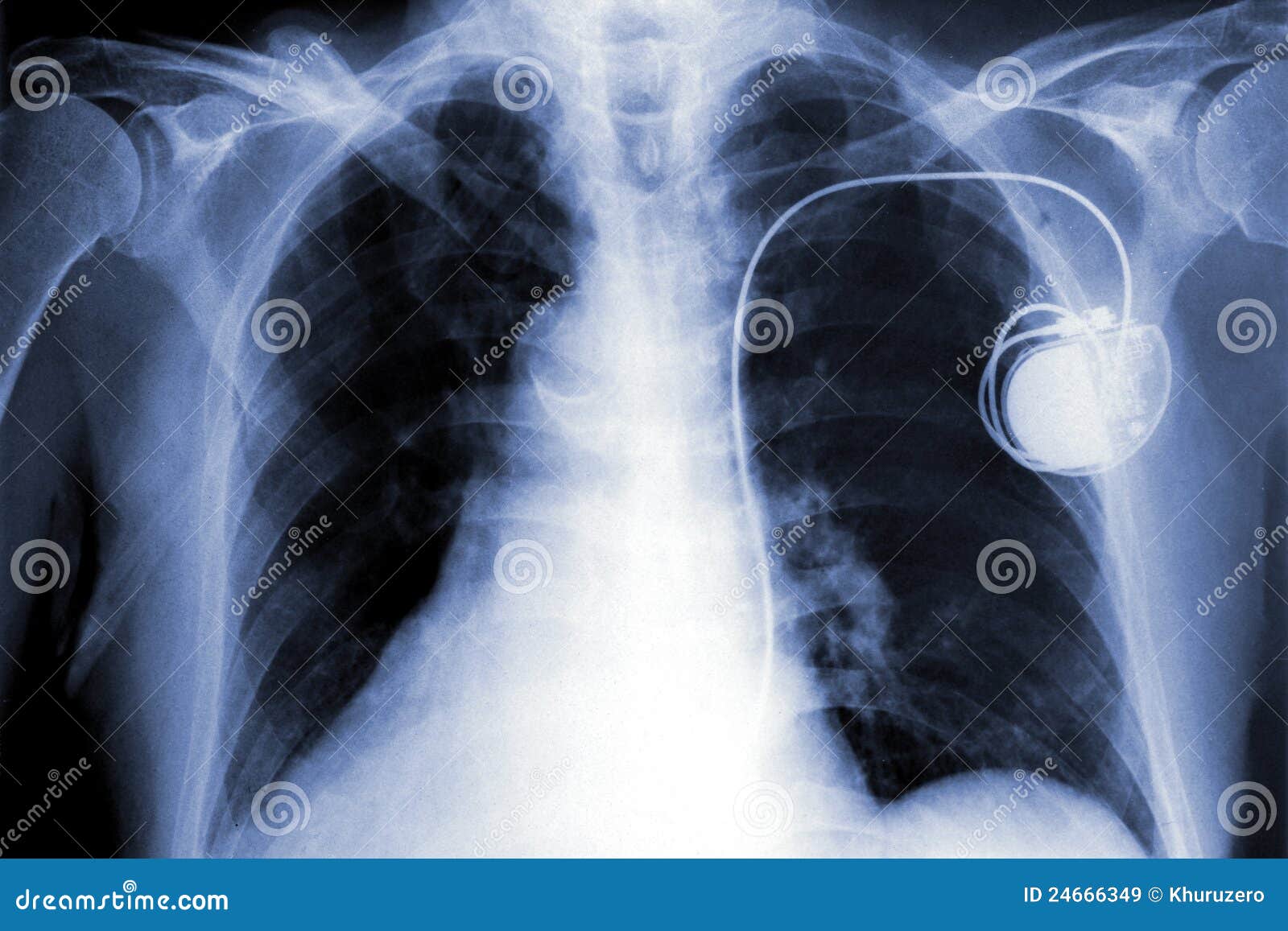 Film radiographique image stock. Image of hôpital, cordon - 24666349