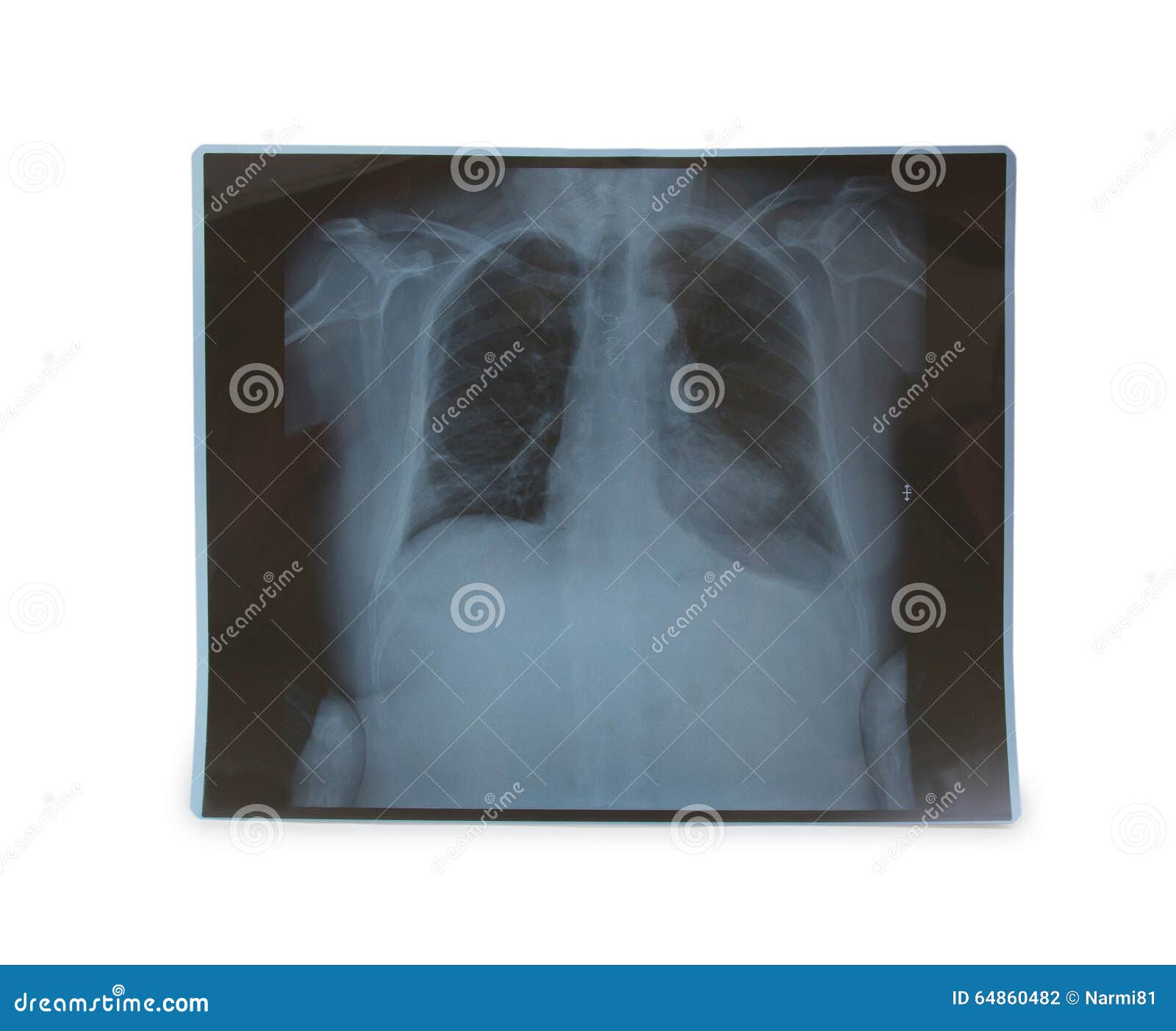 Film Radiographique De Coffre Photo stock - Image du clavicule, santé ...