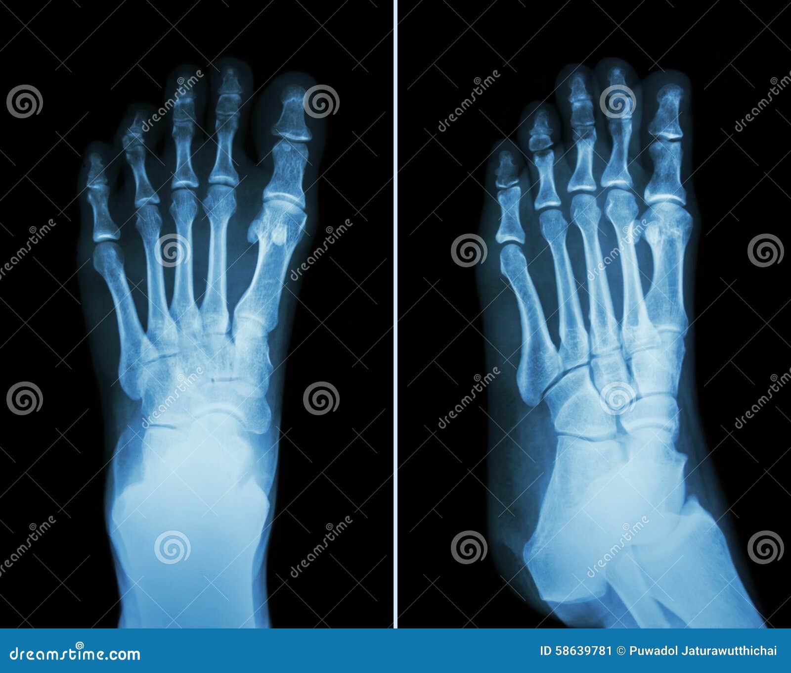 Film X-ray Both Foot ( 2 Position : Front View and Side View ) Stock ...